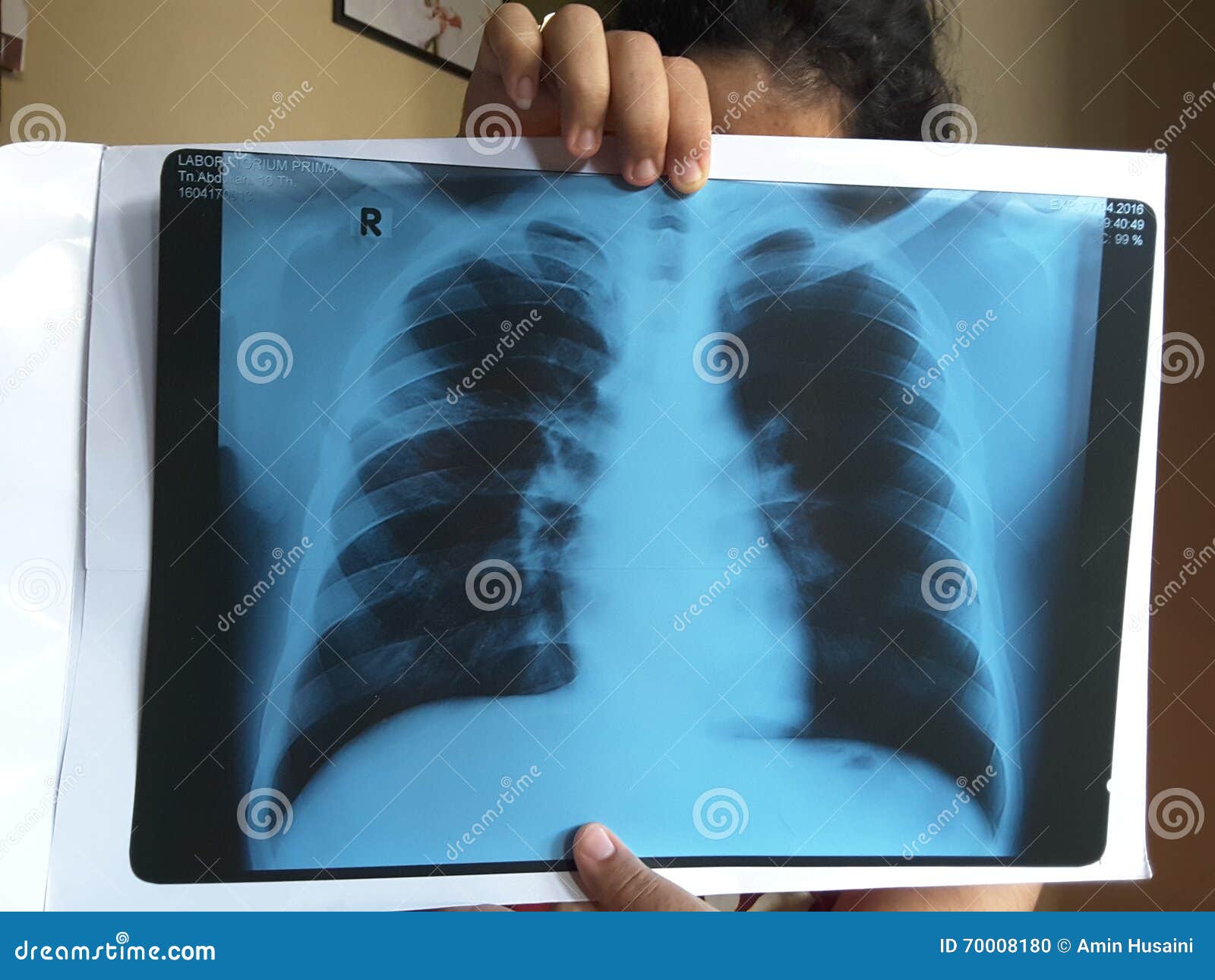Xray editorial image. Image of health, xray, kesehatan - 70008180