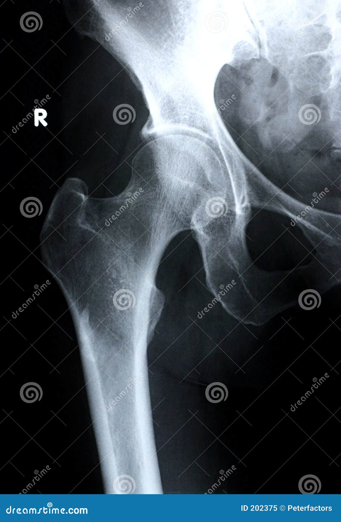 Hip Xray Front View Stock Images by Megapixl