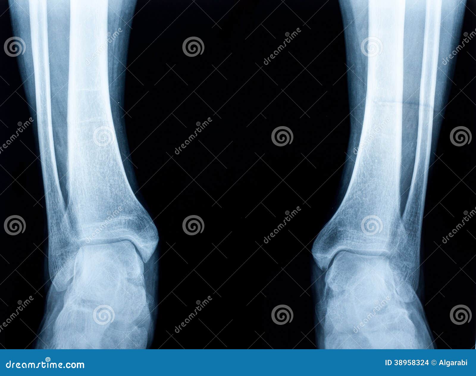 Xray of a human ankle stock photo. Image of break, human - 38958324