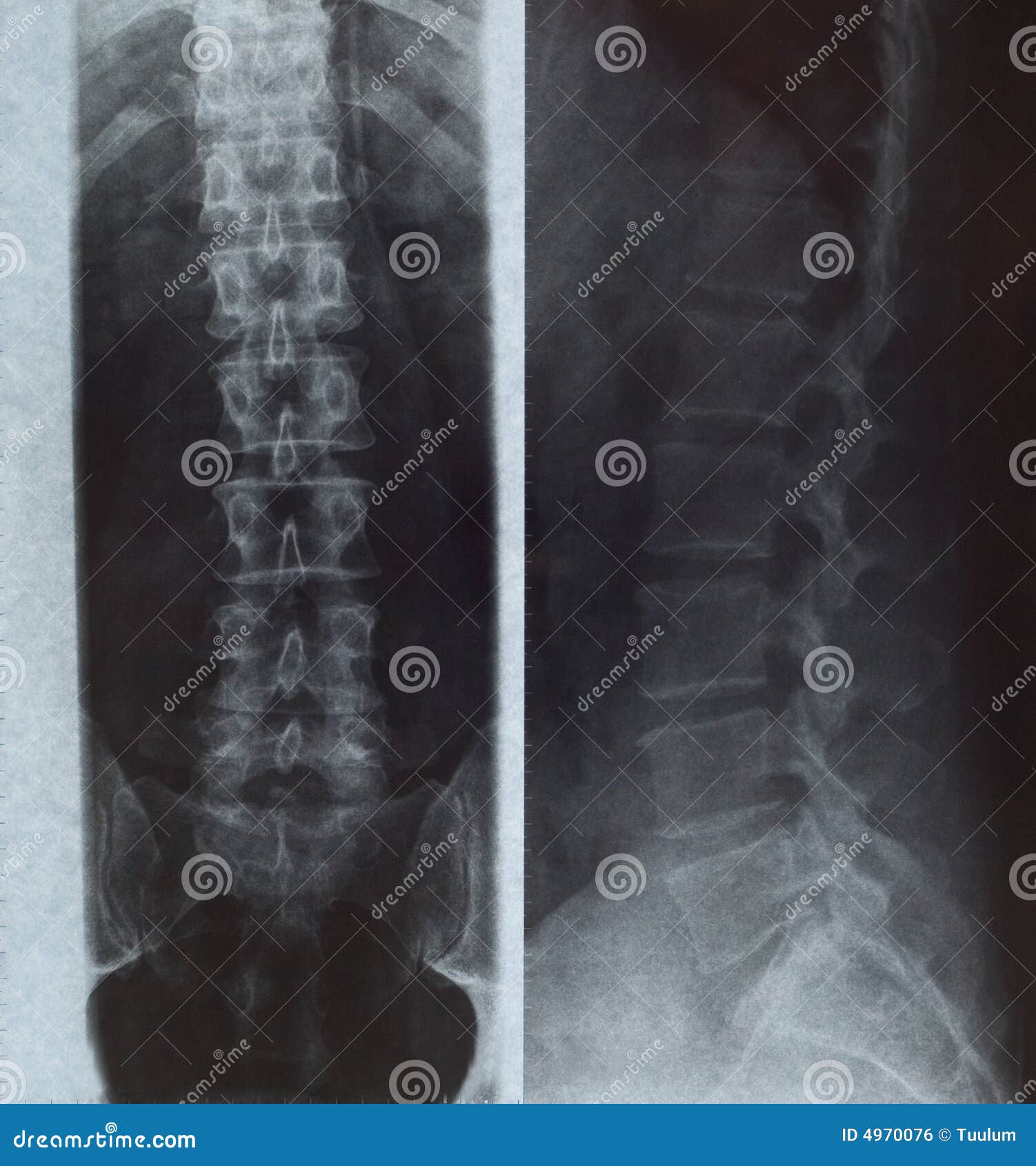 MRI Of Human Spine In Sagittal Or Lateral View.Diagnosis Of Spine ...