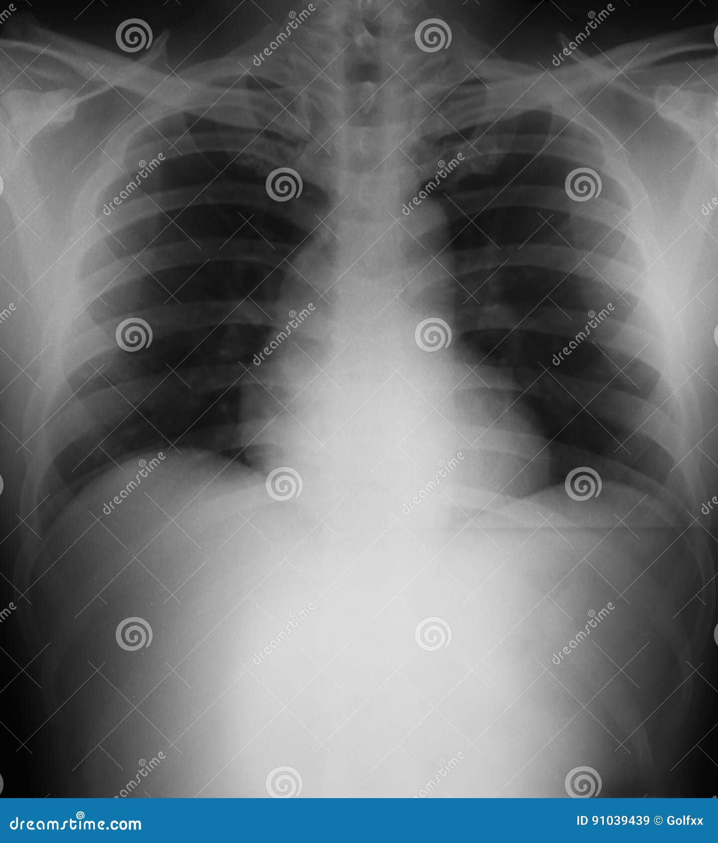 Xray of a human thorax stock image. Image of chest, biology - 91039439