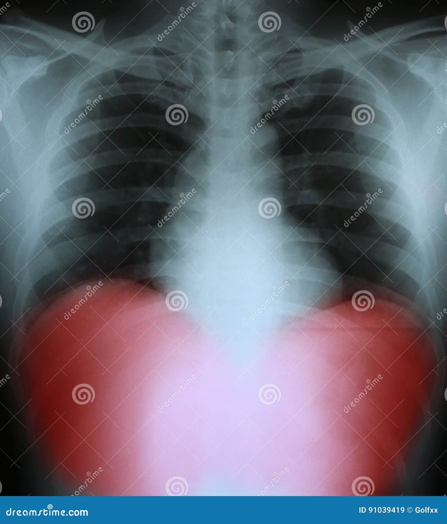 Xray of a Human Thorax with Stomach Highlighted Stock Image - Image of ...