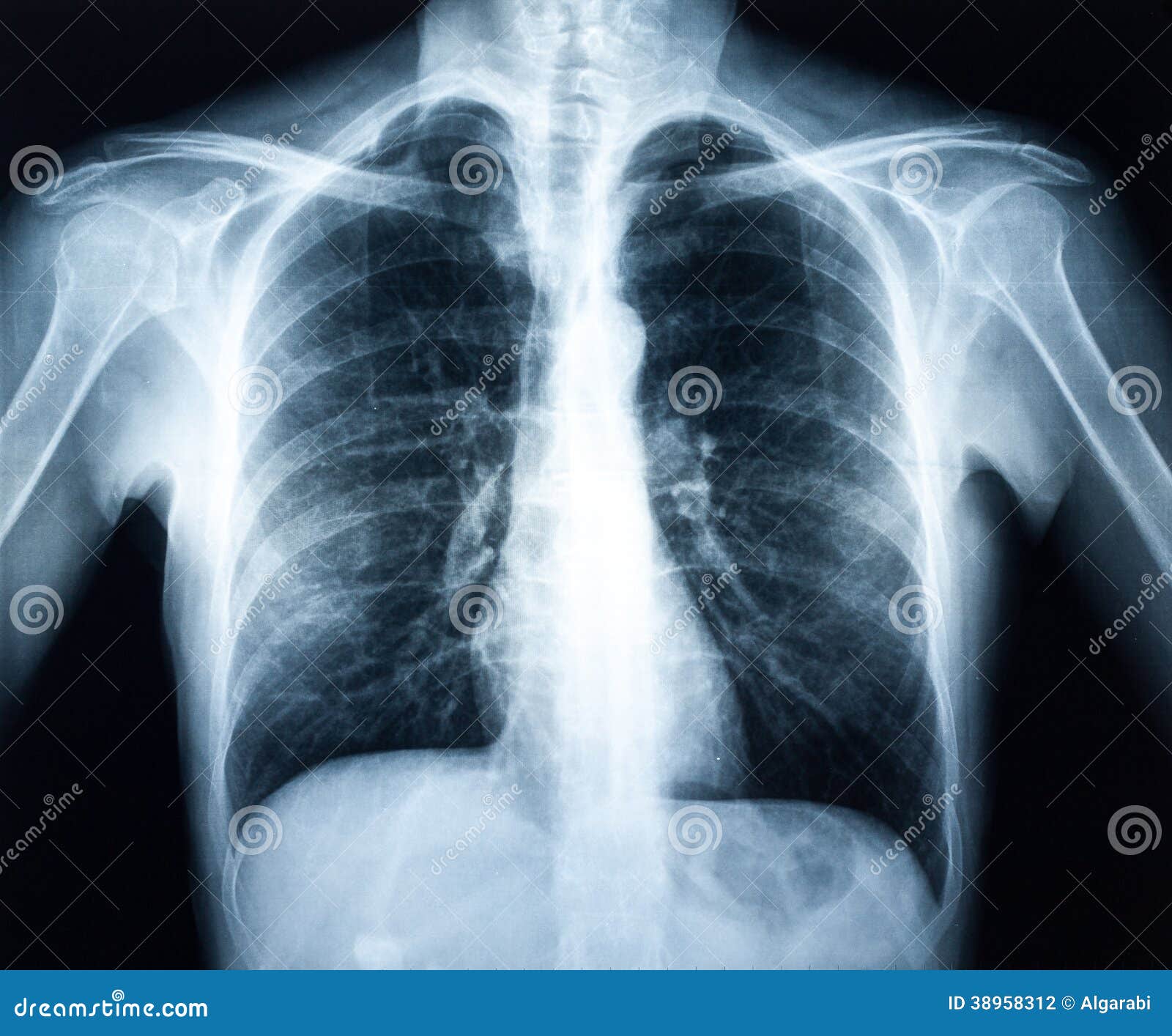 Xray of a human torax stock photo. Image of patient, radiologist - 38958312