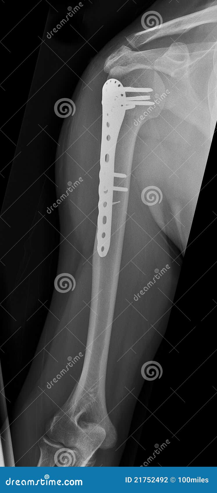 Xray of Humerus with Metallic Implant Stock Photo - Image of health ...