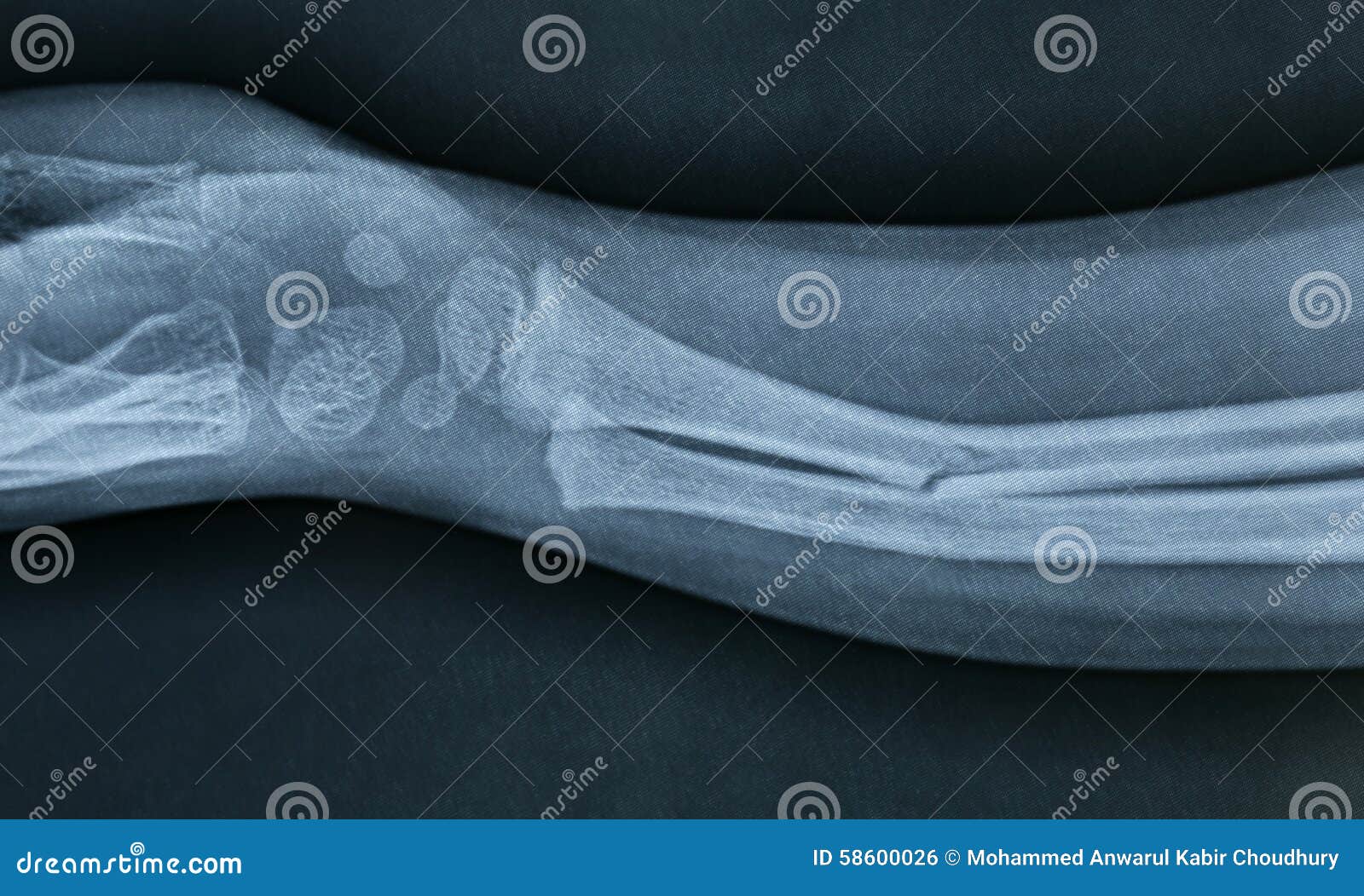 Xray Image of a Broken Hand Stock Photo - Image of medical, white: 58600026