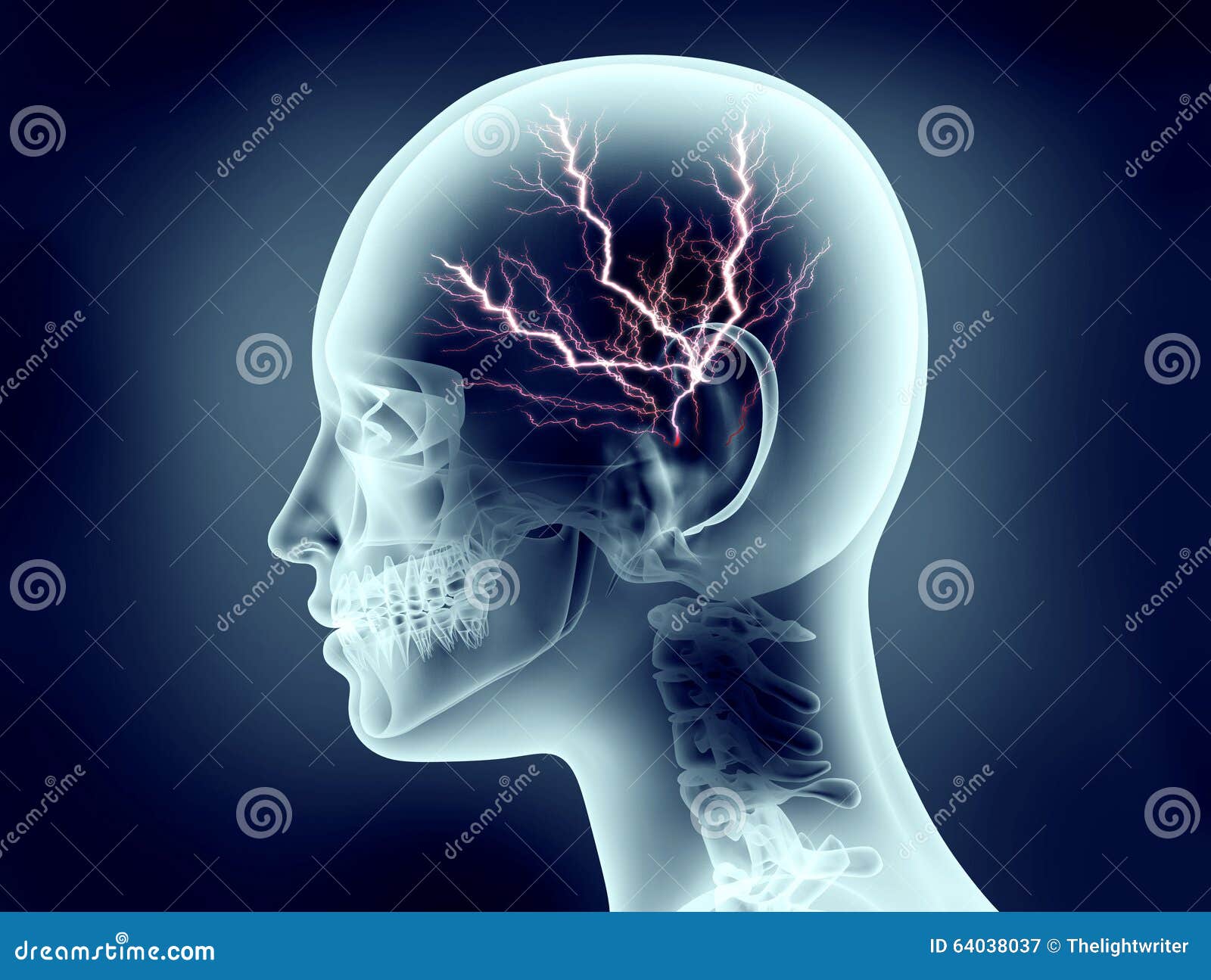 3D Radiograph With Head Injury Royalty-Free Stock Photography ...