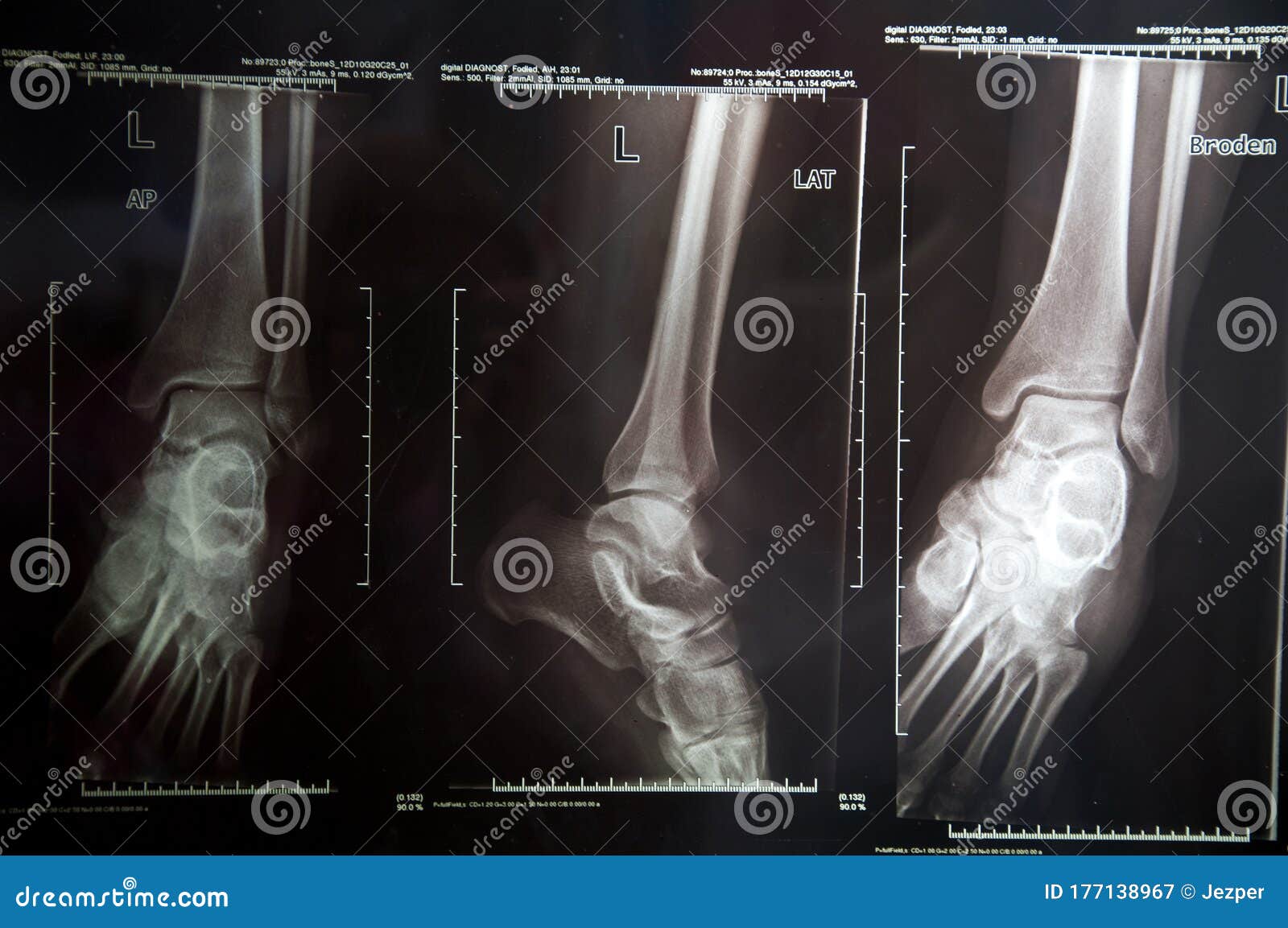 Xray image of human leg stock image. Image of radiological - 177138967