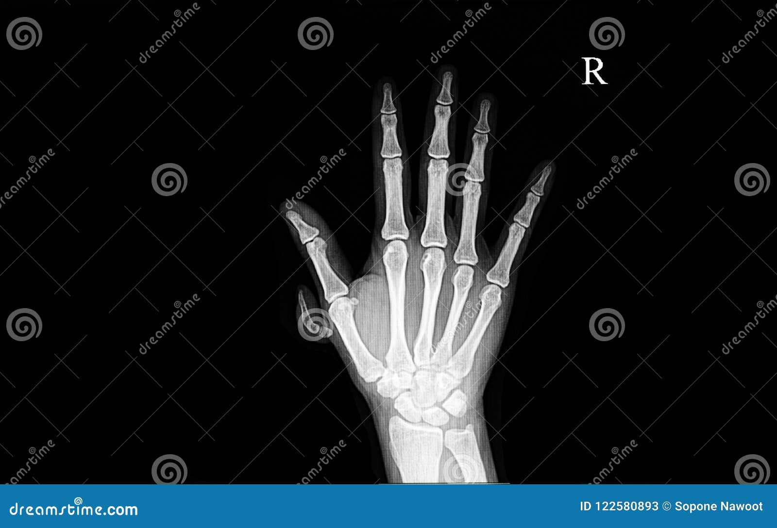 Polydactyly On Human; Rare Abnormal Characteristic Causes By Chromosome ...