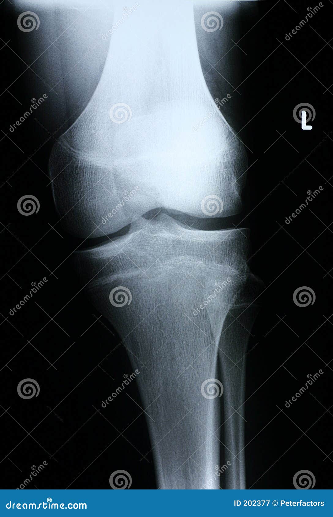 Xray/Knee front stock image. Image of broken, internal - 202377