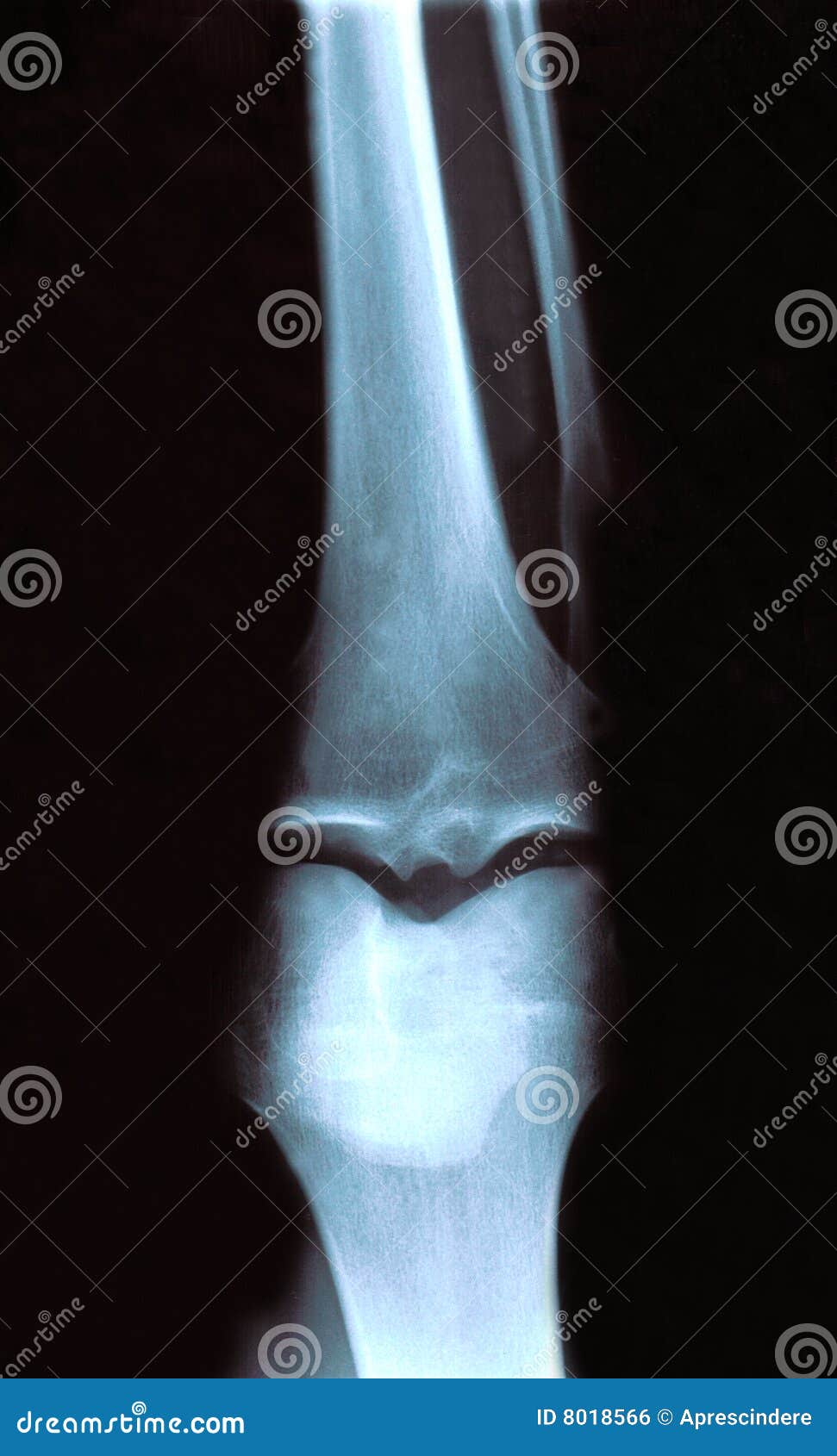 Knee Xray Of A Patient Showing A Lucent Line At Lower Part Of Patella ...