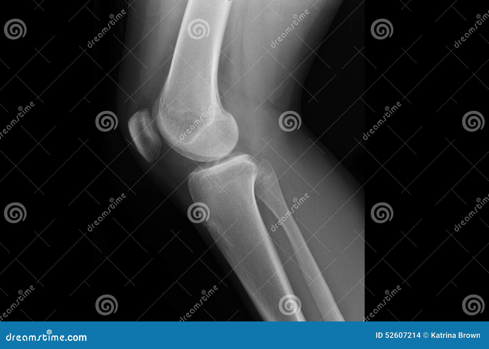 Xray Knee Joints of an Adolescent Stock Photo - Image of adult ...