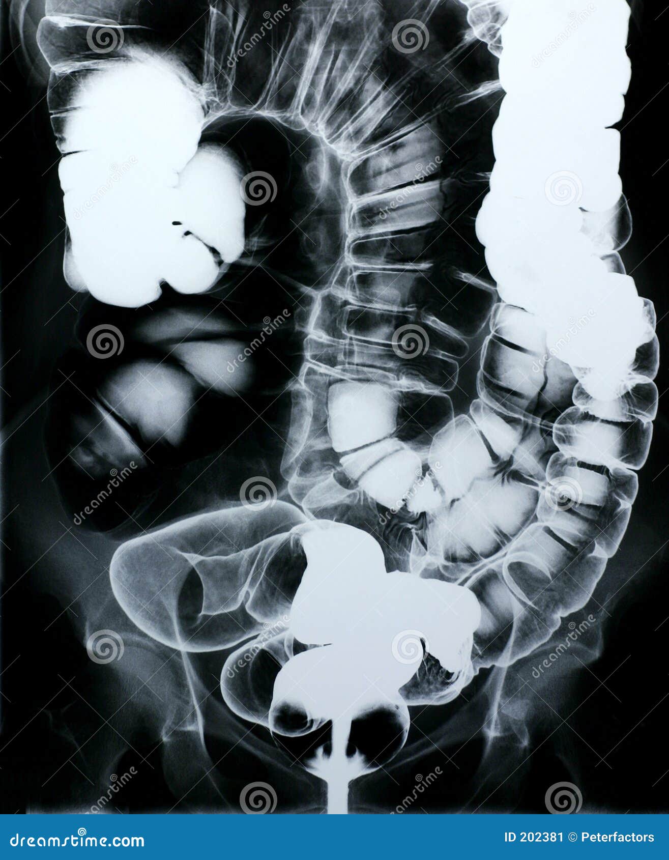 Xray large colon stock image. Image of brain, broken, hospital - 202381