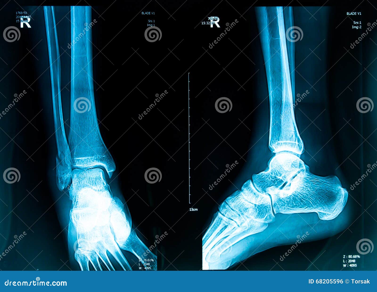Xray picture stock photo. Image of hospital, radiation - 68205596