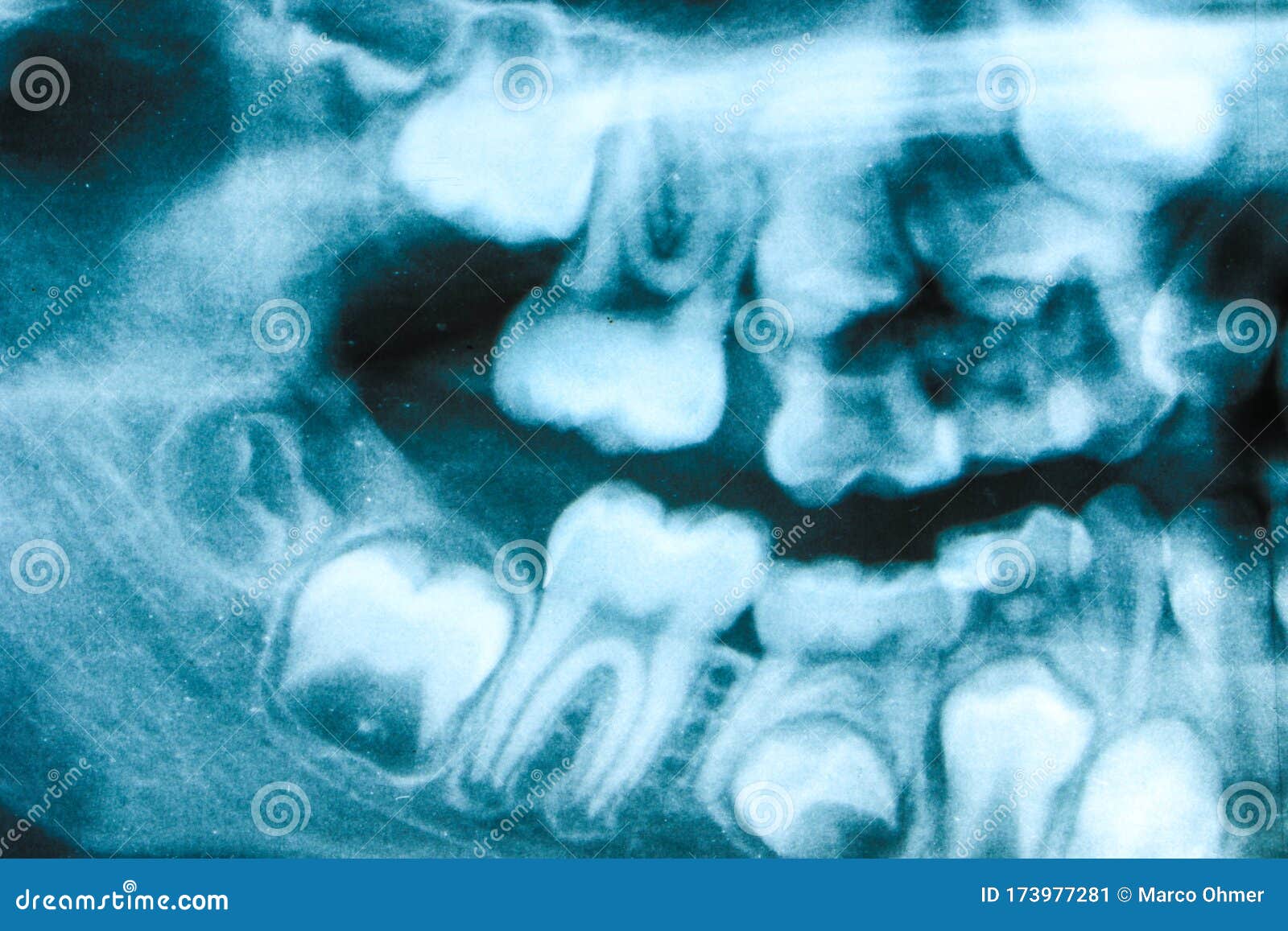 Xray scan of teeth stock image. Image of mouth, human - 173977281