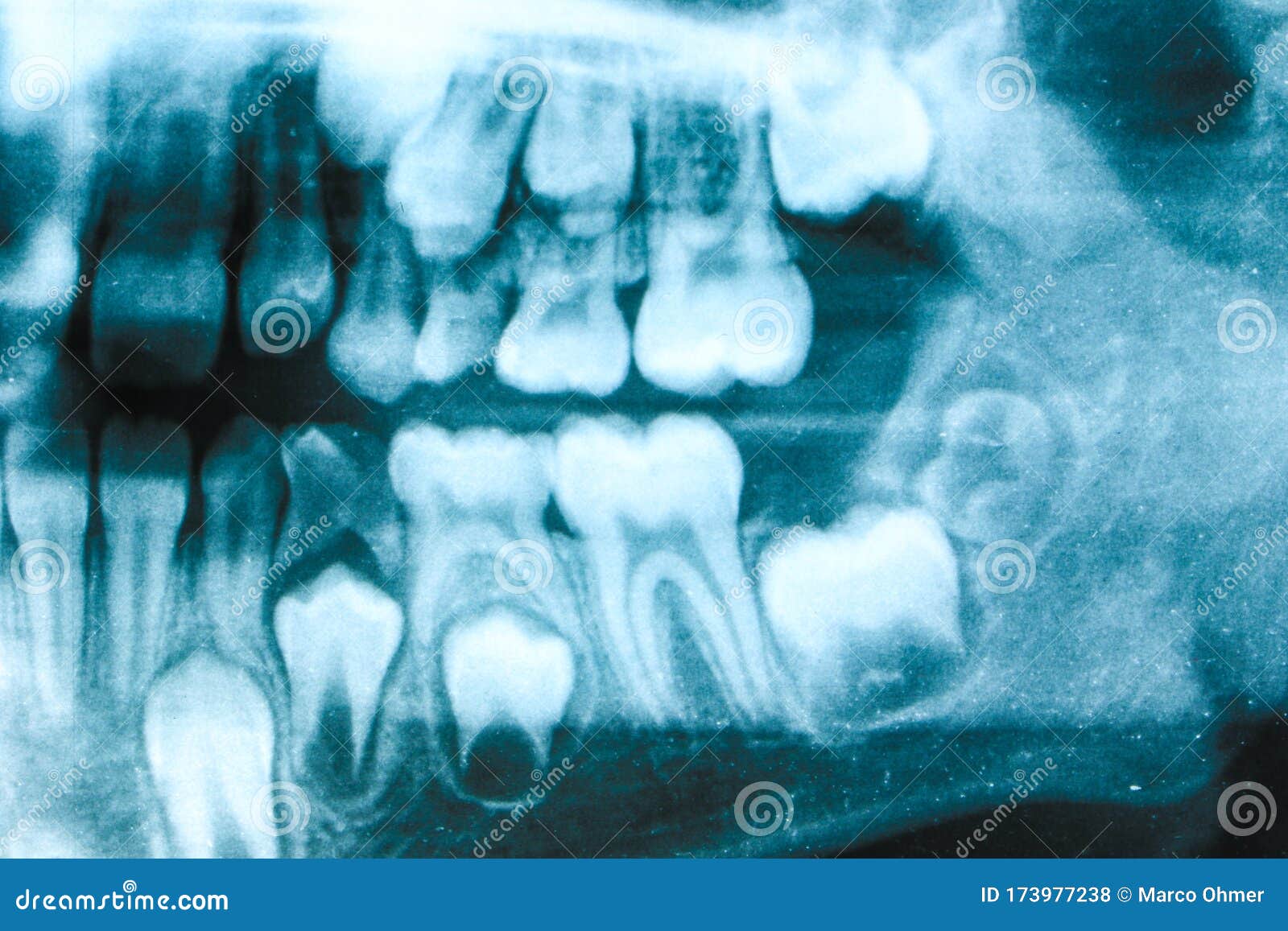 Xray scan of teeth stock photo. Image of head, nature - 173977238