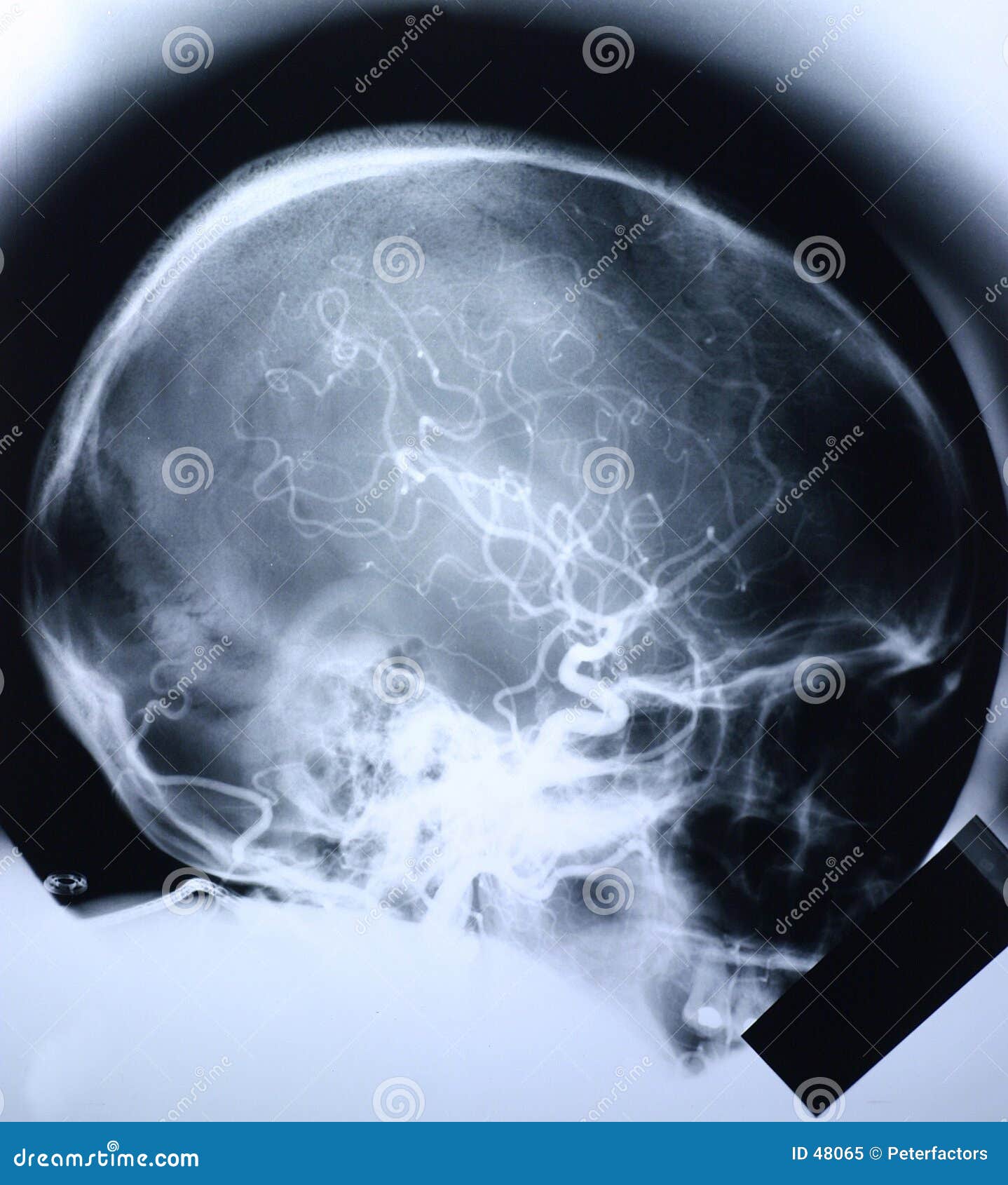 Skull Xray Causes Symptoms Treatment Skull Xray