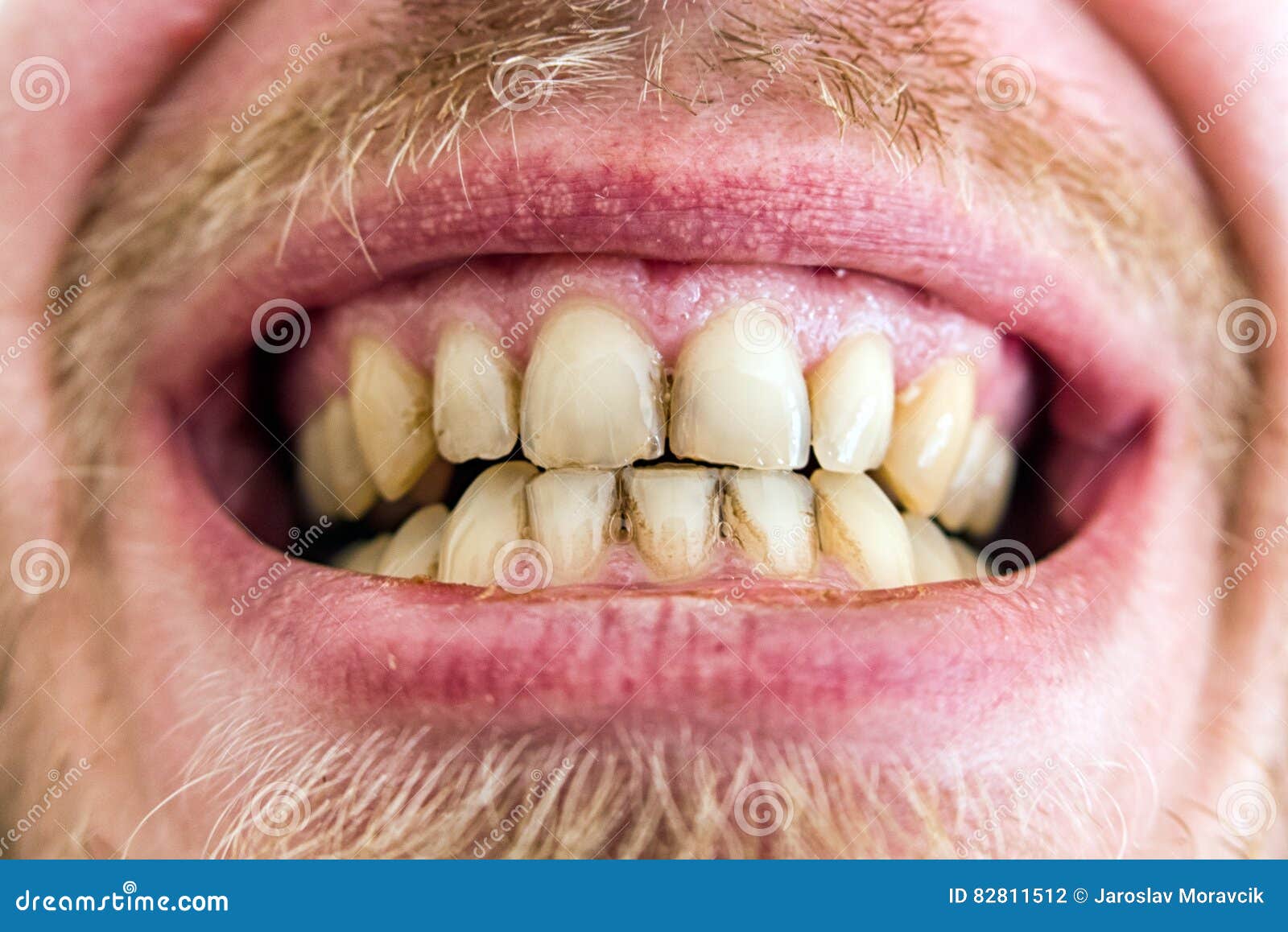 Yellow teeth plaque stock photo. Image of teeth, dental - 82811512
