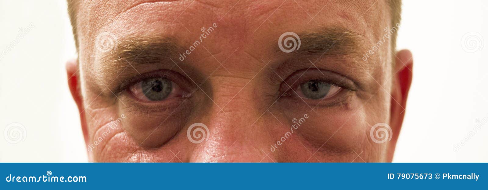 Yeux Rouges Gonflés D'Allergie Image stock - Image du blanc, rouge ...