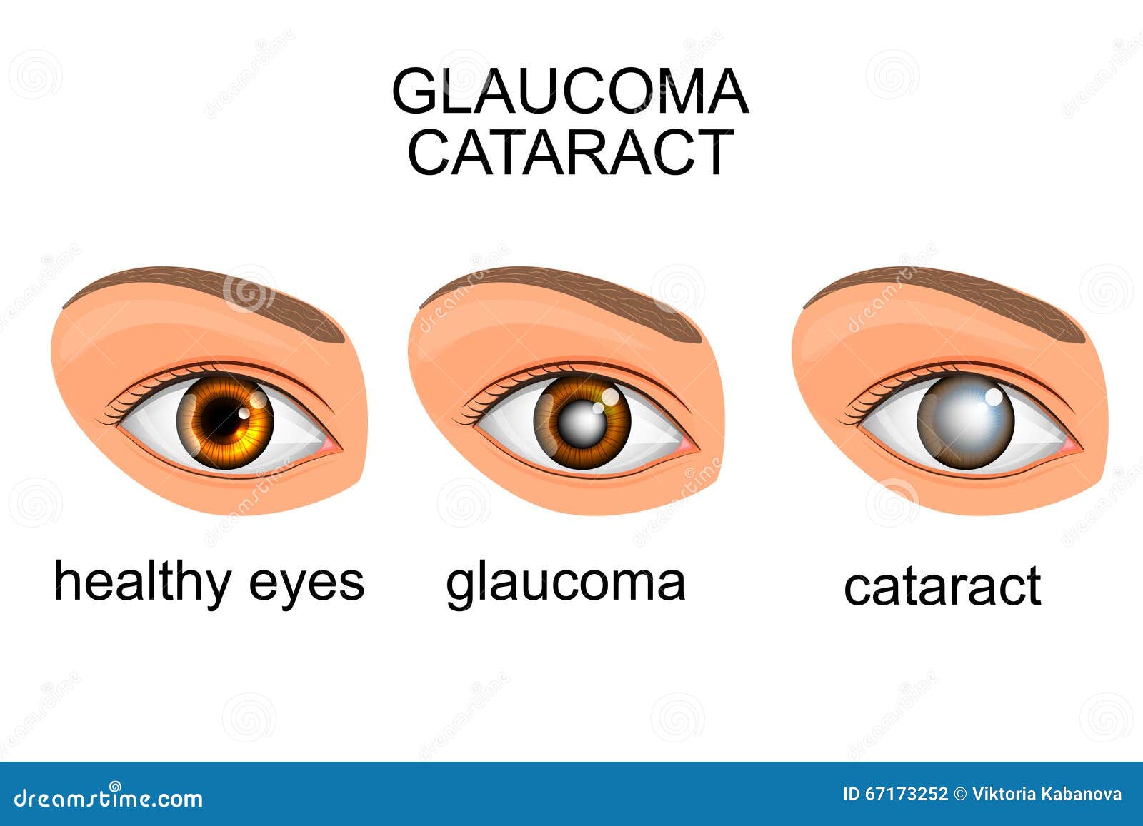 Yeux Sains, Glaucome, Cataractes Illustration de Vecteur - Illustration ...