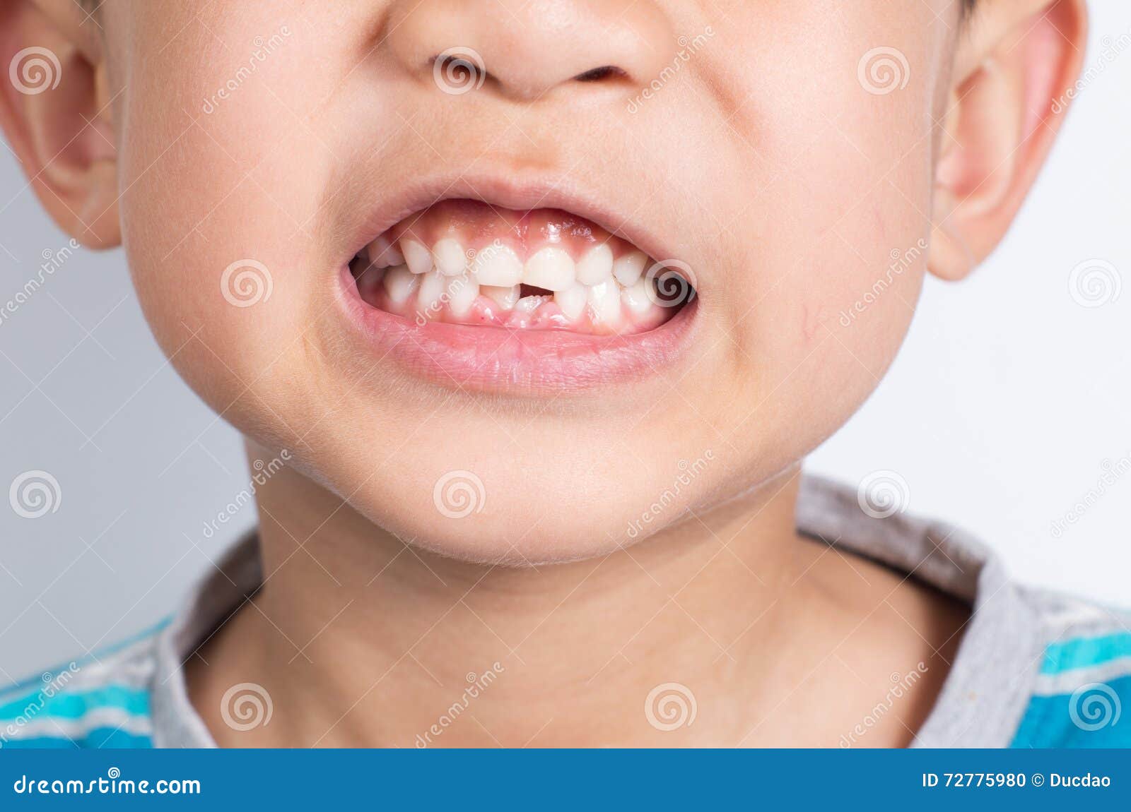 Young Asian Boy Showing Two Missing Frontal Teeth Stock Photo - Image ...