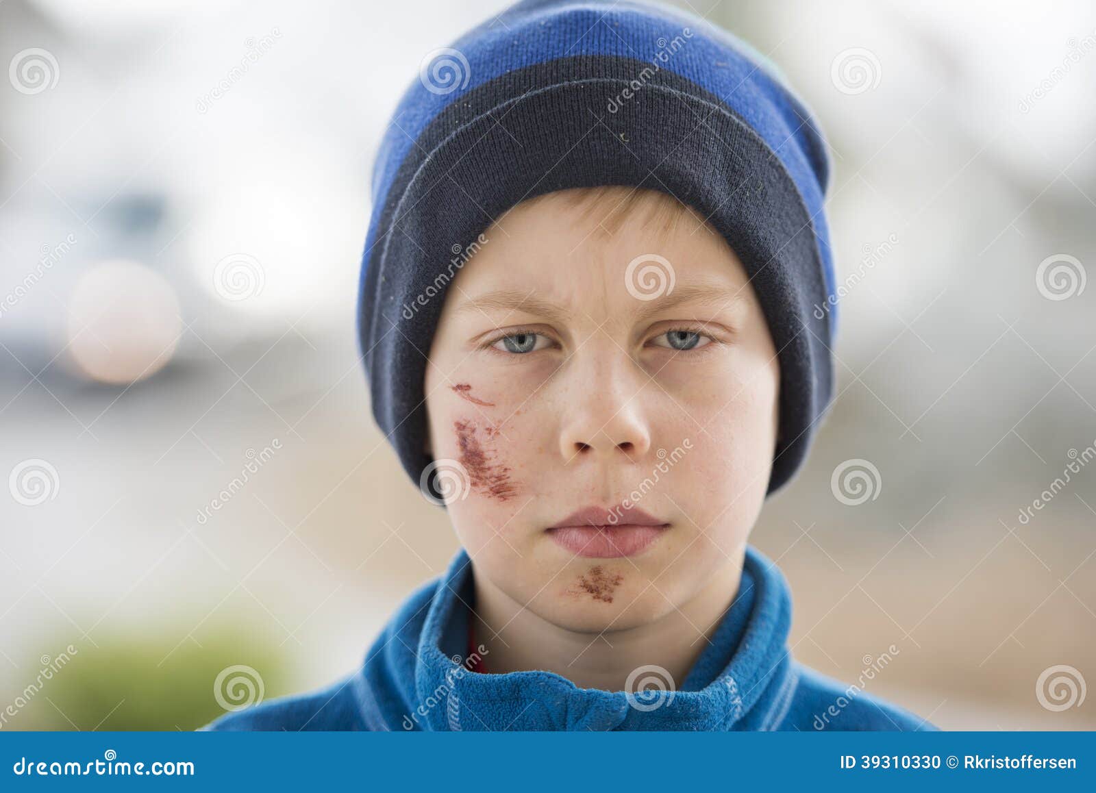 Young Boy with a Face Injury Stock Photo - Image of scratch, human ...