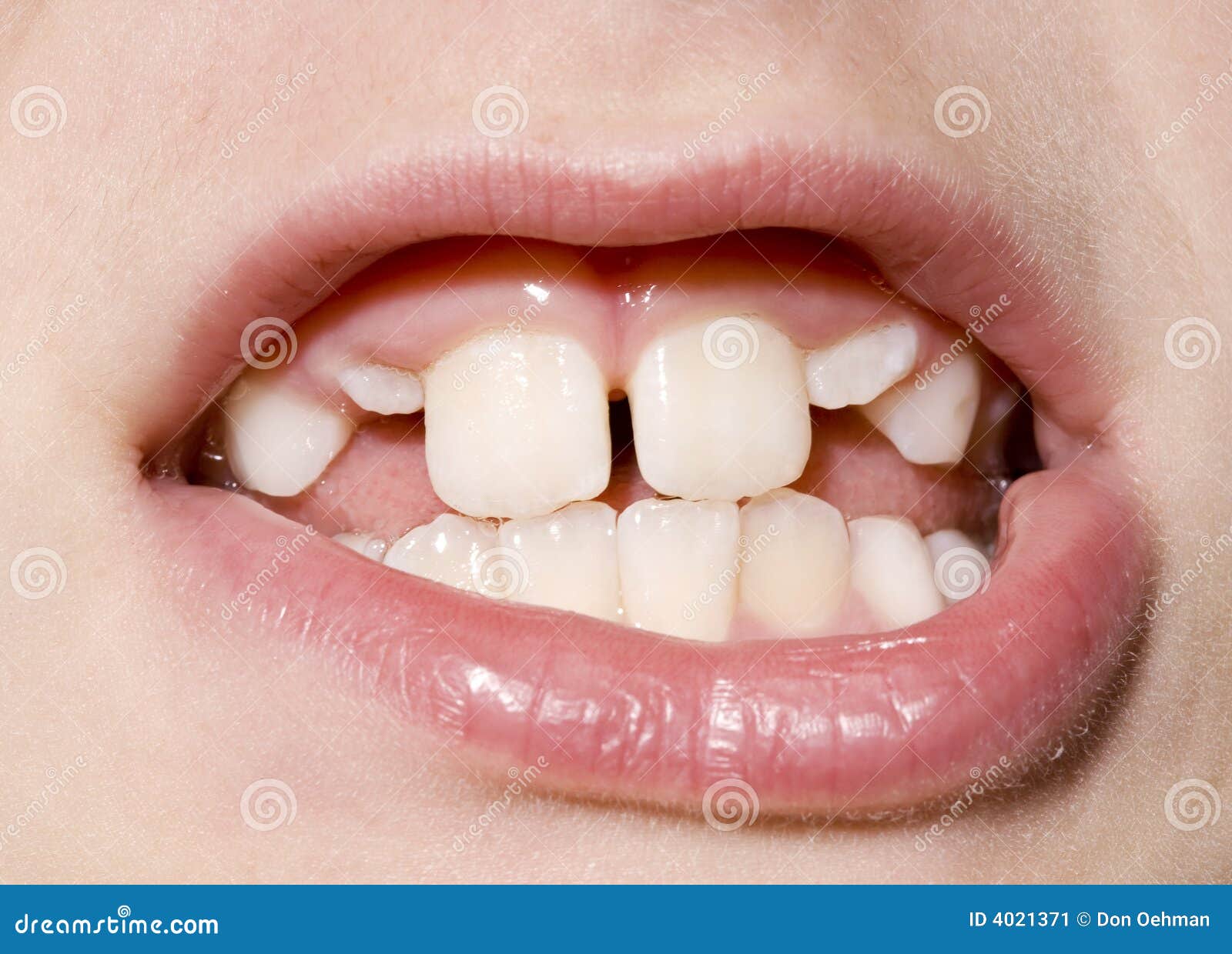 Young Boy s Teeth Closeup stock image. Image of child - 4021371