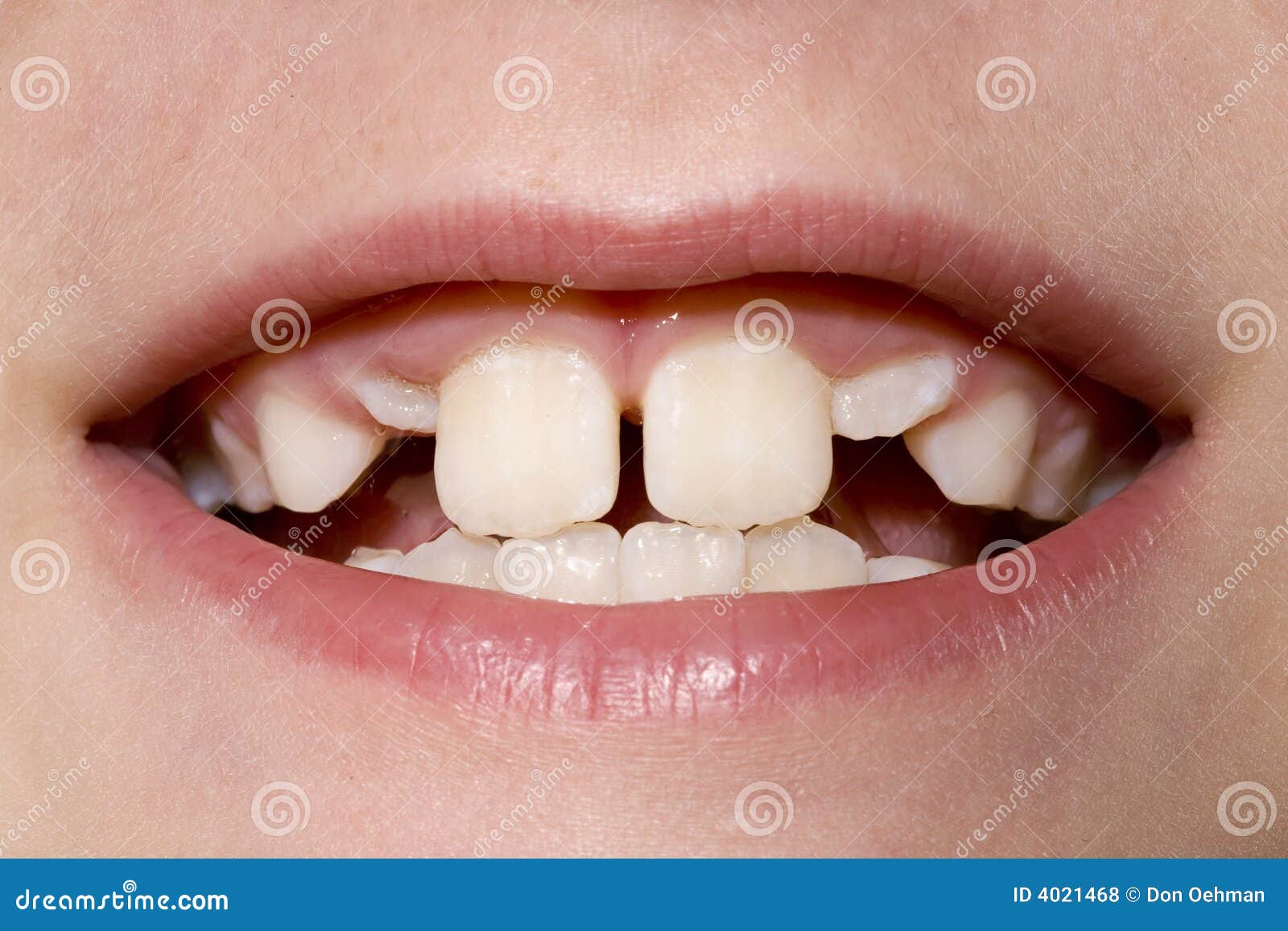 Young Boy s Teeth Closeup stock photo. Image of smile - 4021468