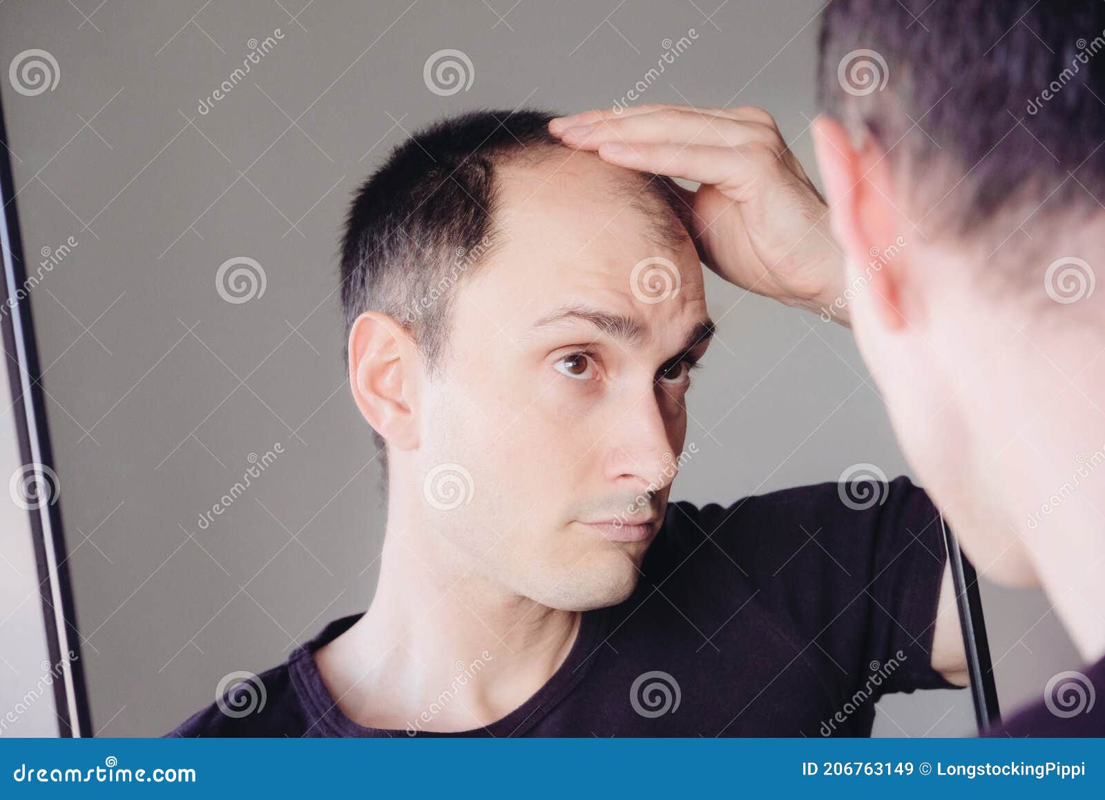 A Young Balding Bald Man Yells And Screams Holding His Head. The ... A Young Balding Bald Man Yells And Screams Holding His Head. The ...