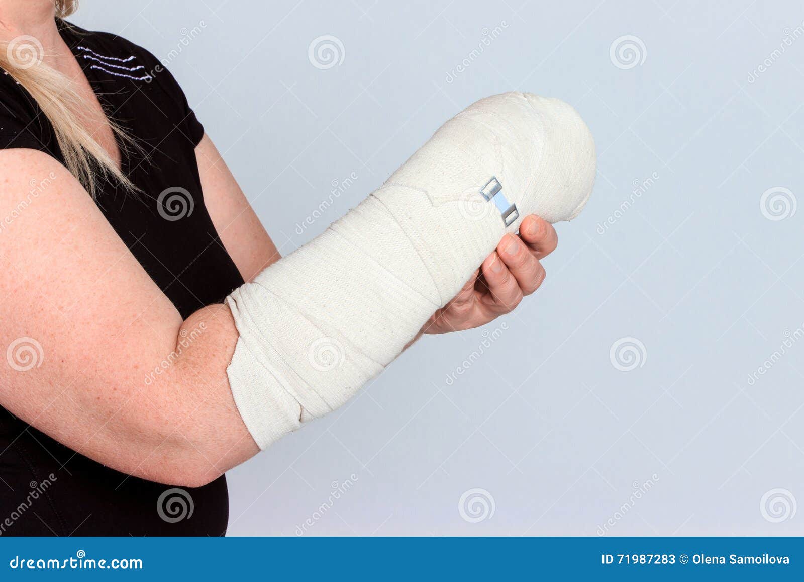 Broken Hand Cast