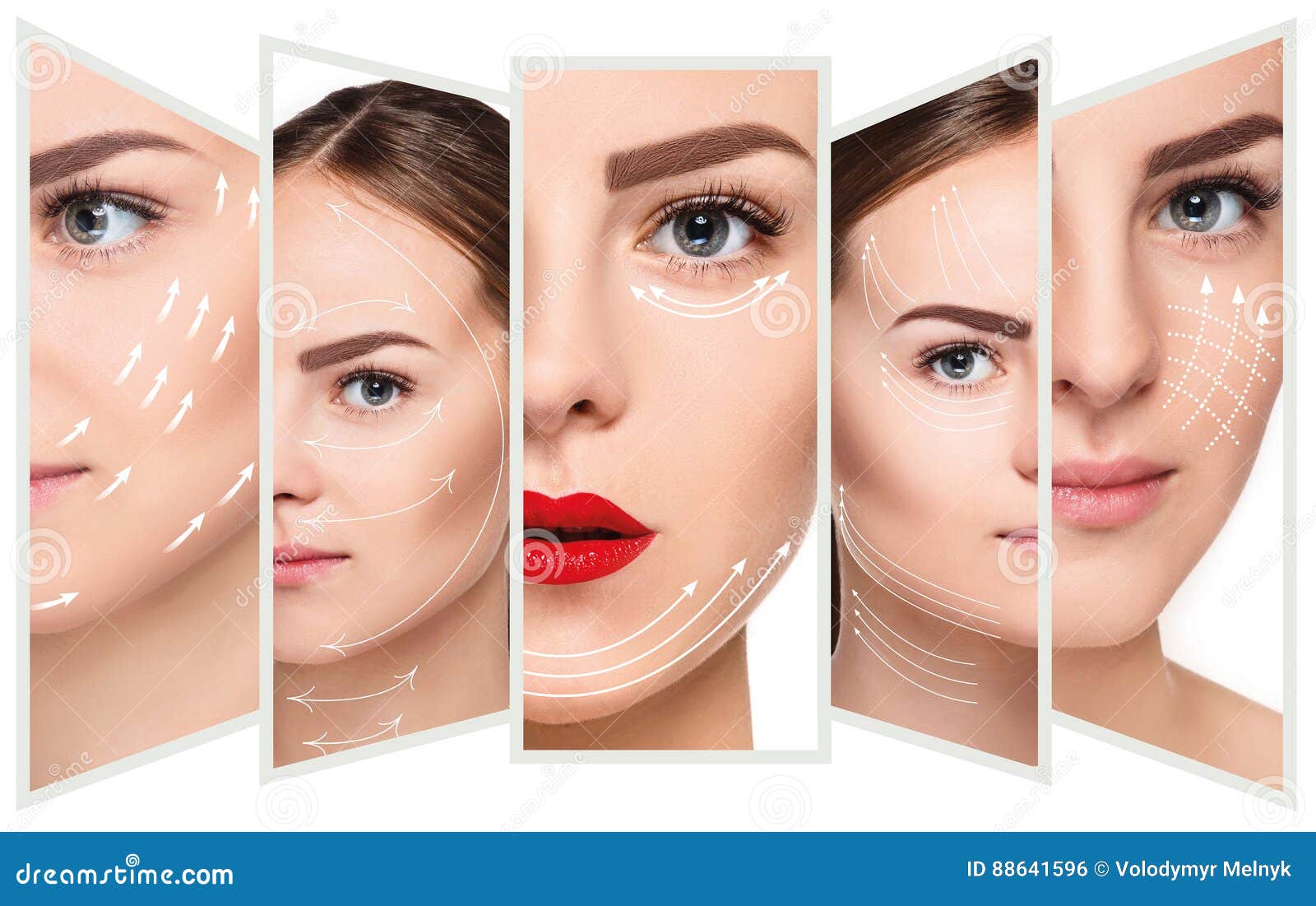 Thread Lifting - A Minimally Invasive Procedure For Tightening Skin Of ...