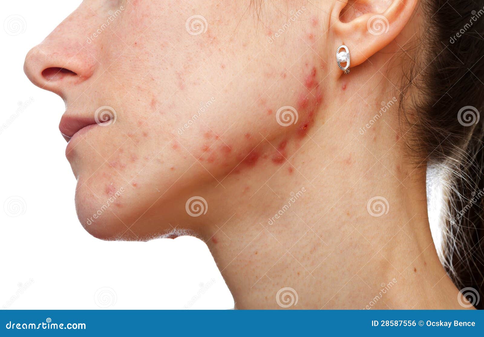Young Girl with Skin Problem Stock Photo - Image of female, hormone ...