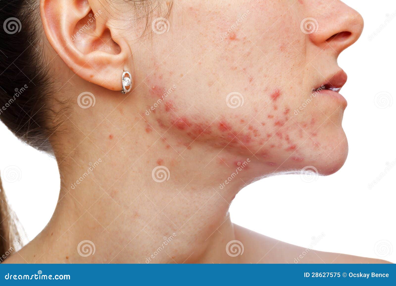 Skin Problem With Acne Diseases, Close Up Woman Face With Whitehead ...