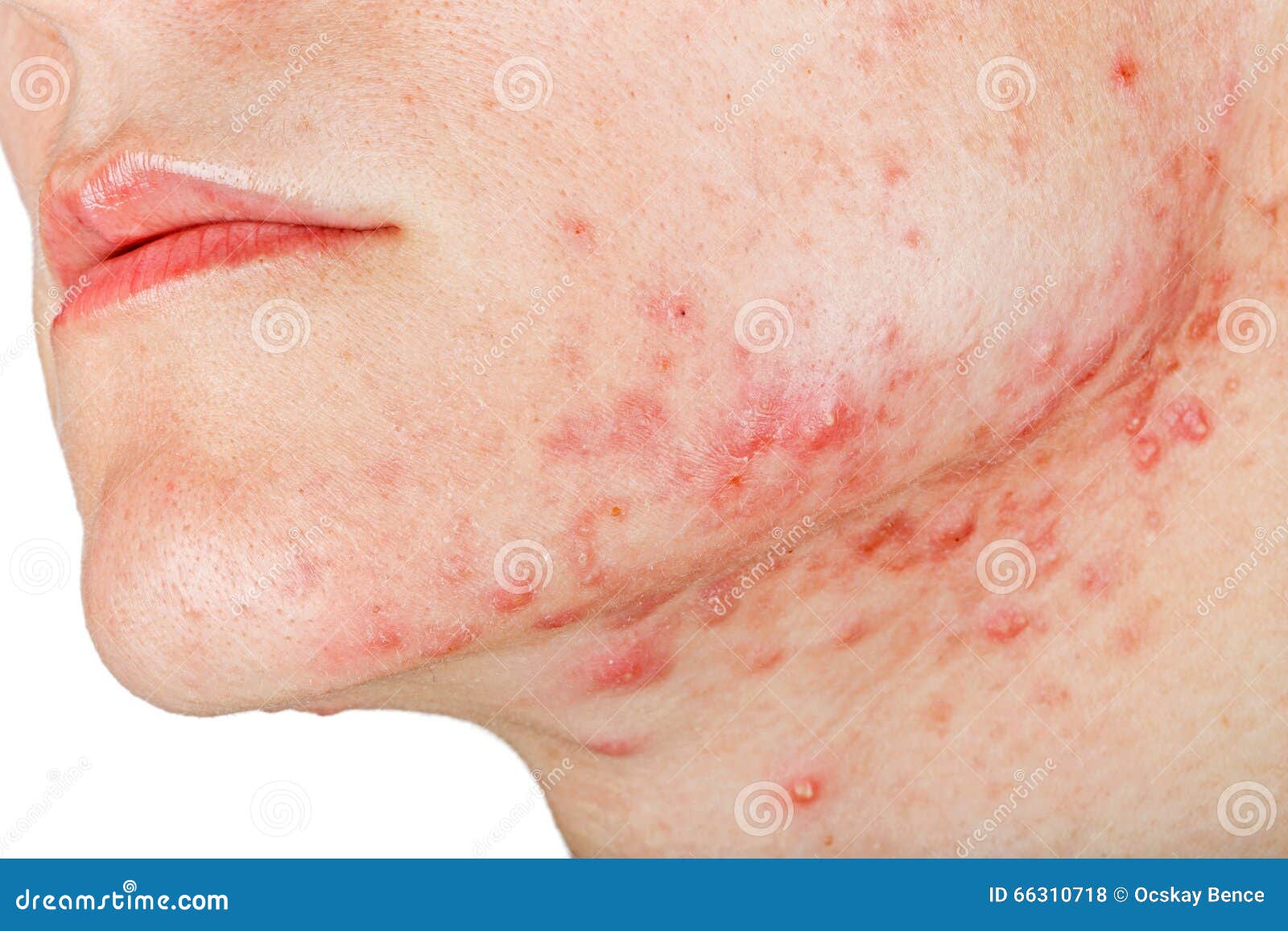 Young Girl with Skin Problem Stock Photo - Image of head, bacteria ...