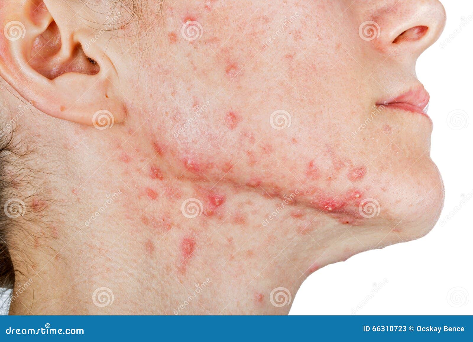 Young Girl with Skin Problem Stock Image - Image of closeup, acne: 66310723