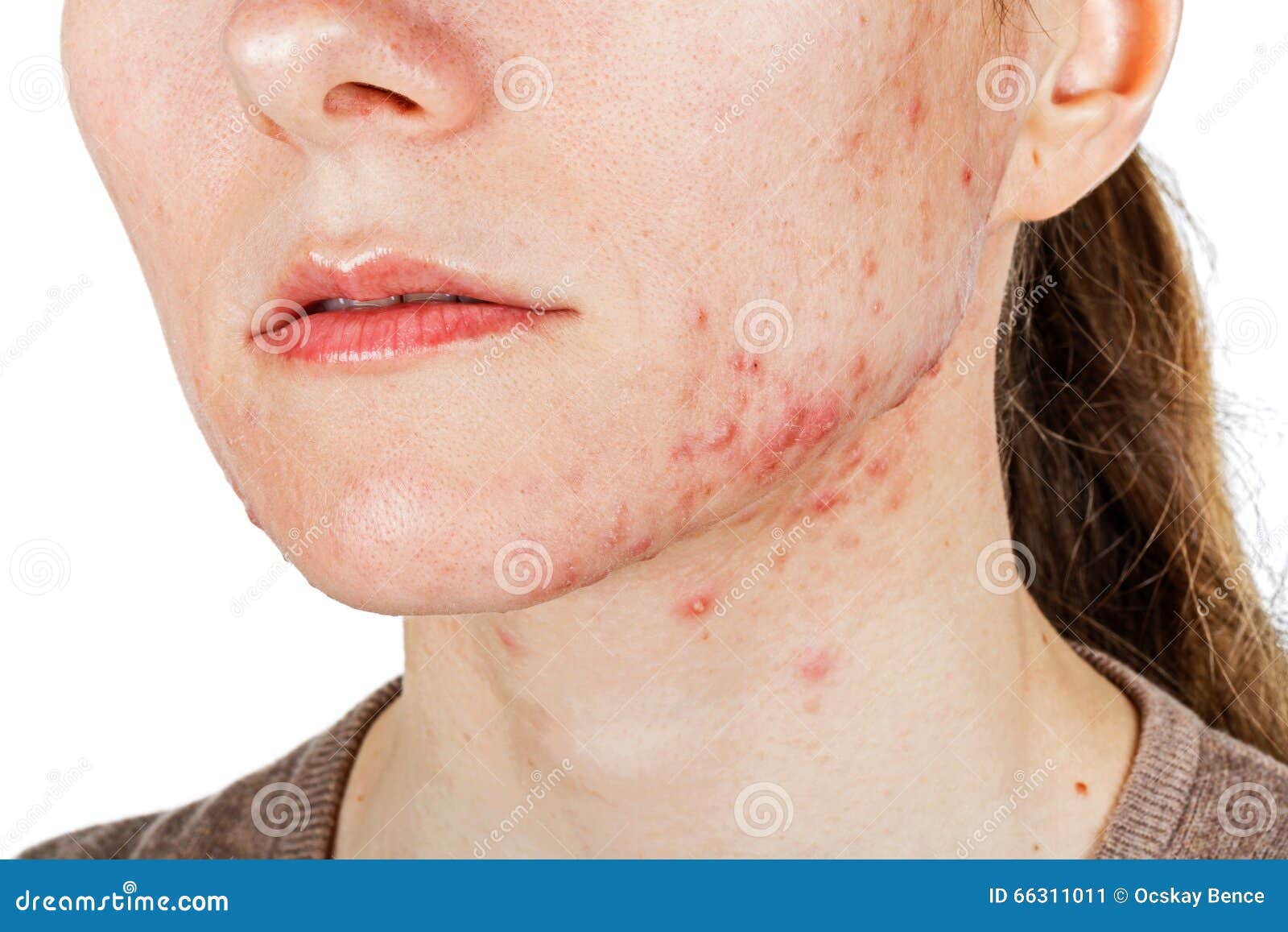 Young Girl with Skin Problem Stock Image - Image of blemishes, hair ...