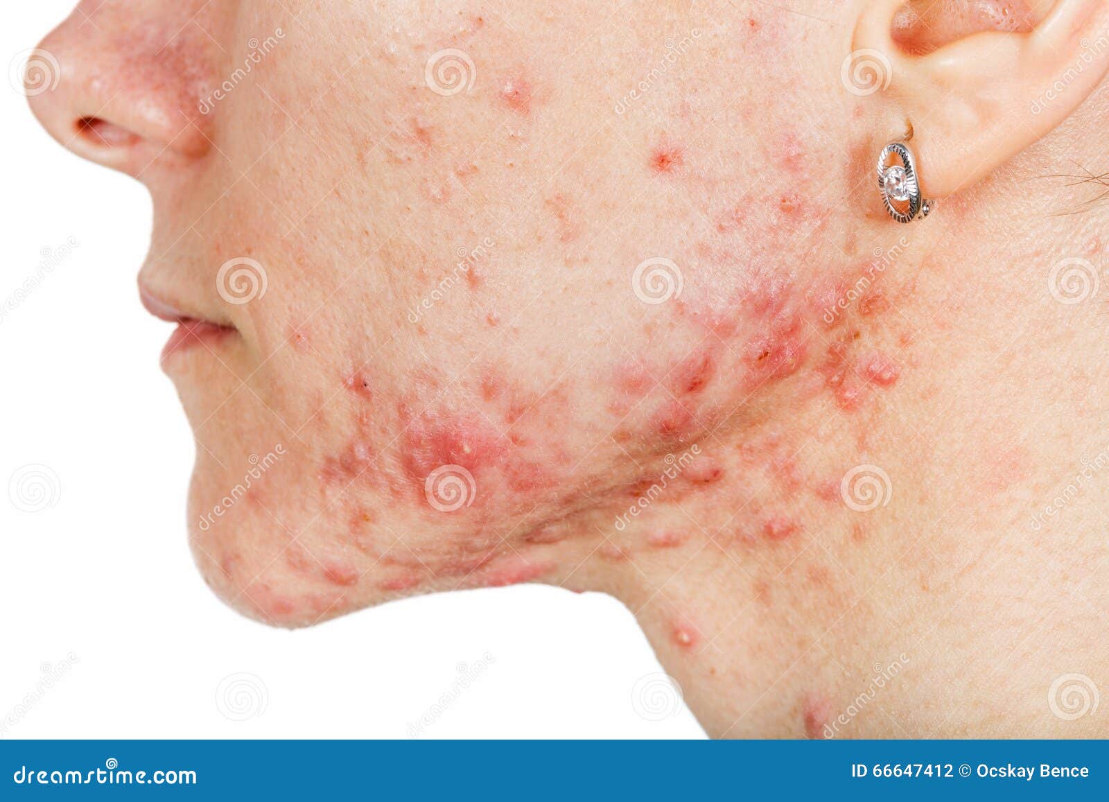 Skin Problem With Acne Diseases, Close Up Woman Face With Whitehead ...