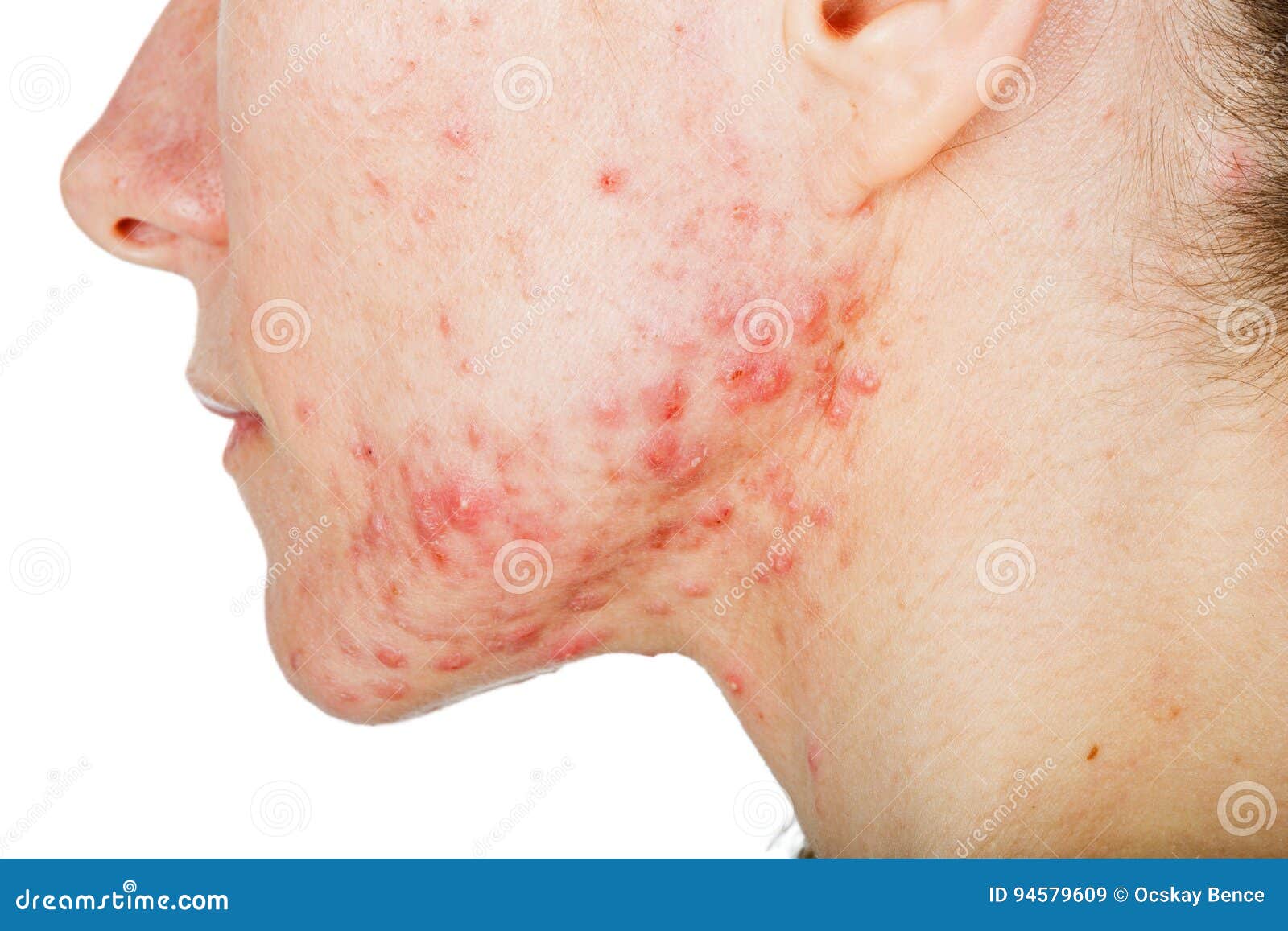 Young Girl with Skin Problem Stock Image - Image of chin, disorders ...