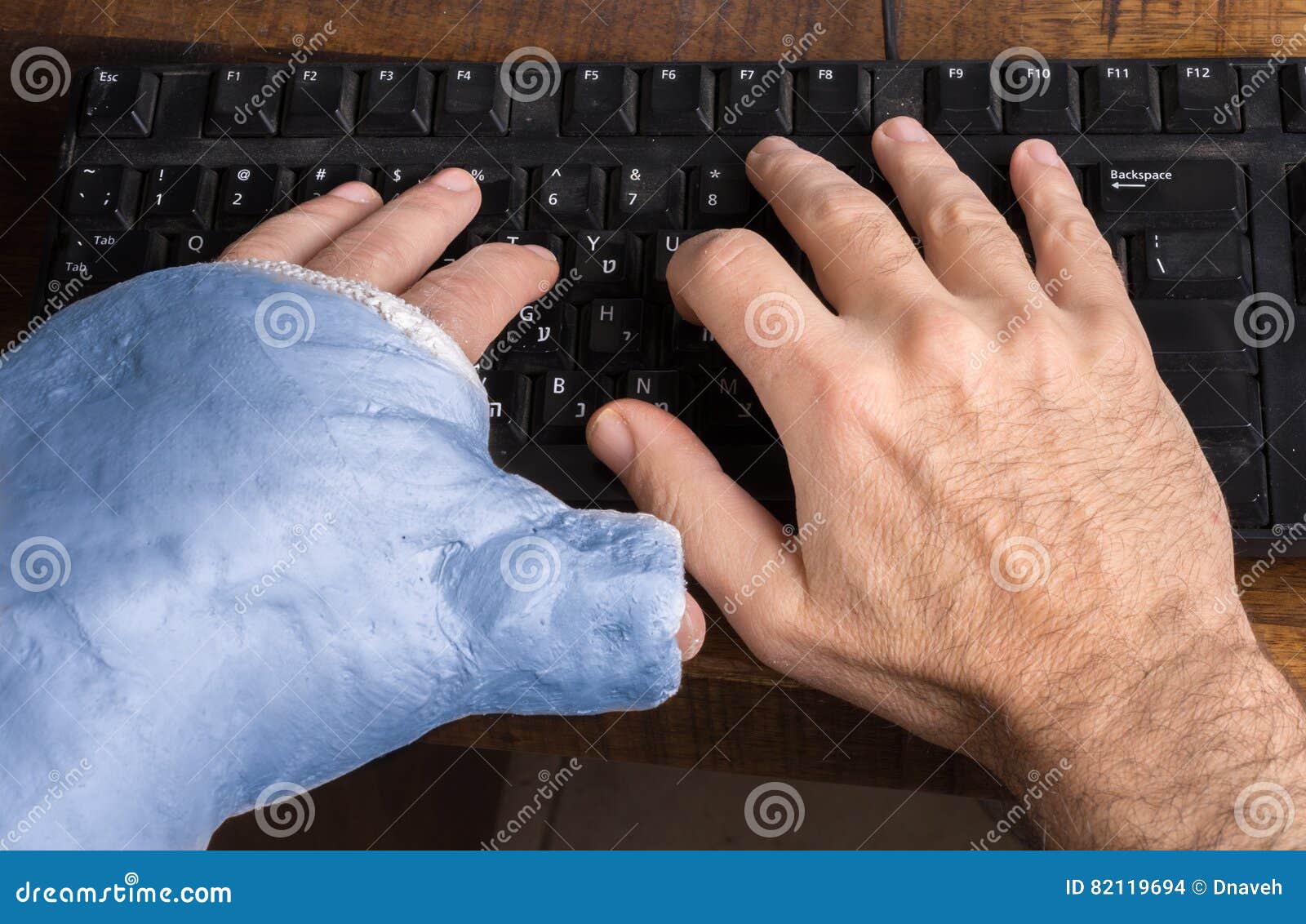 Young Man with Arm Cast Typing on a Keyboard Stock Photo - Image of ...
