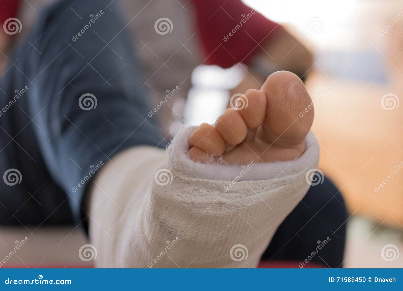 Young Man with a Broken Ankle and a Leg Cast Stock Photo - Image of ...
