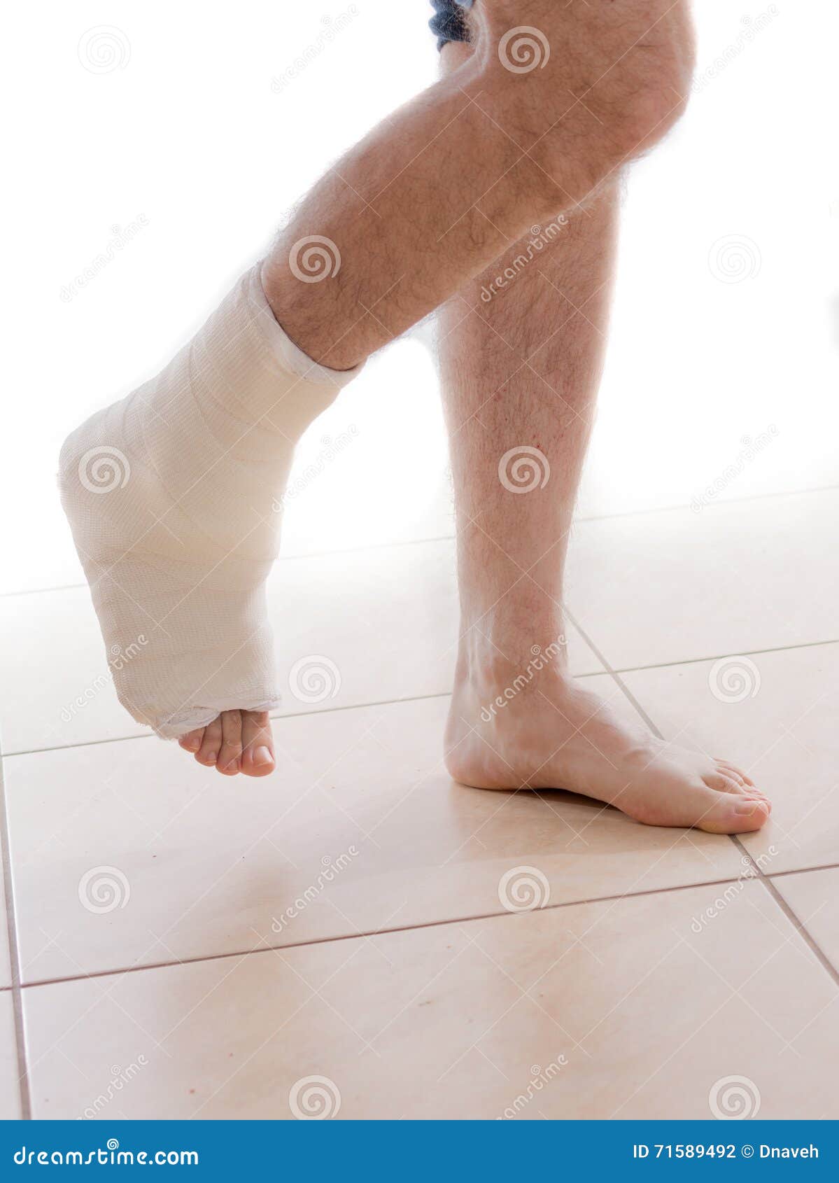 Young Man with a Broken Ankle and a Leg Cast Stock Photo - Image of ...