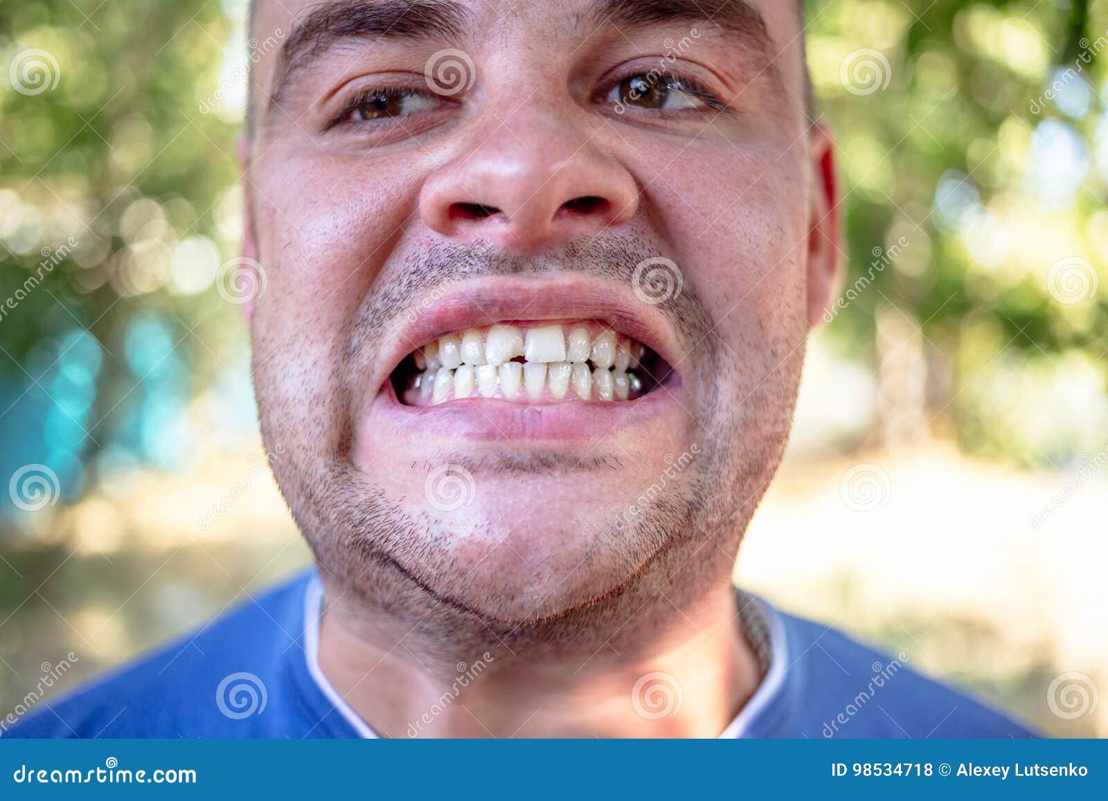 Young Man with a Chipped Tooth Stock Photo - Image of hygiene, laugh ...