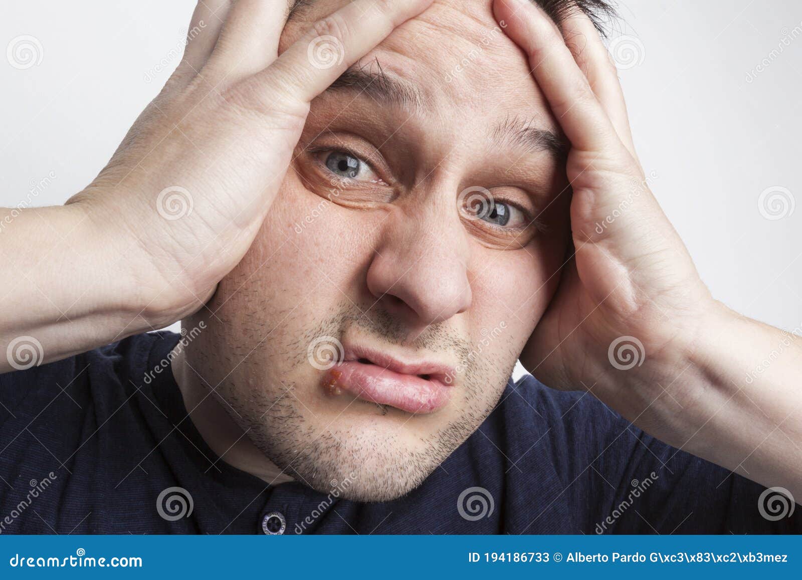 Young man with cold sore stock image. Image of lips - 194186733