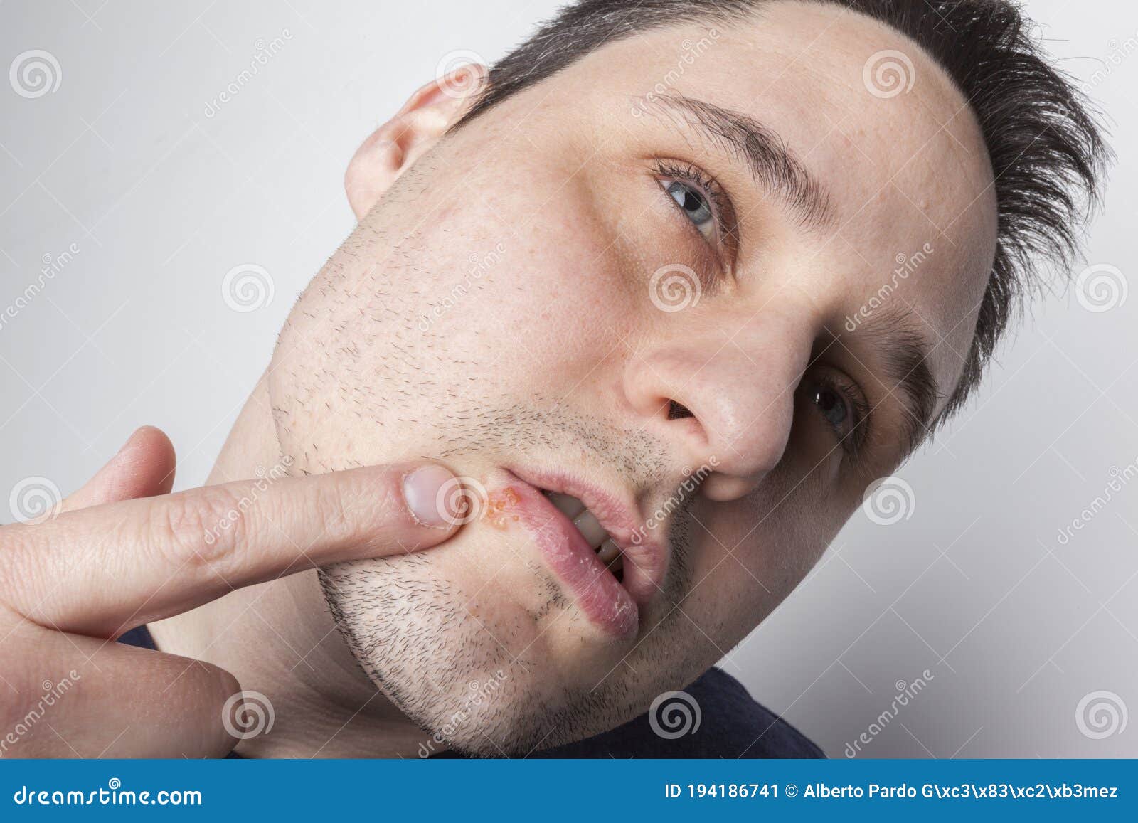 Young man with cold sore stock image. Image of physical - 194186741