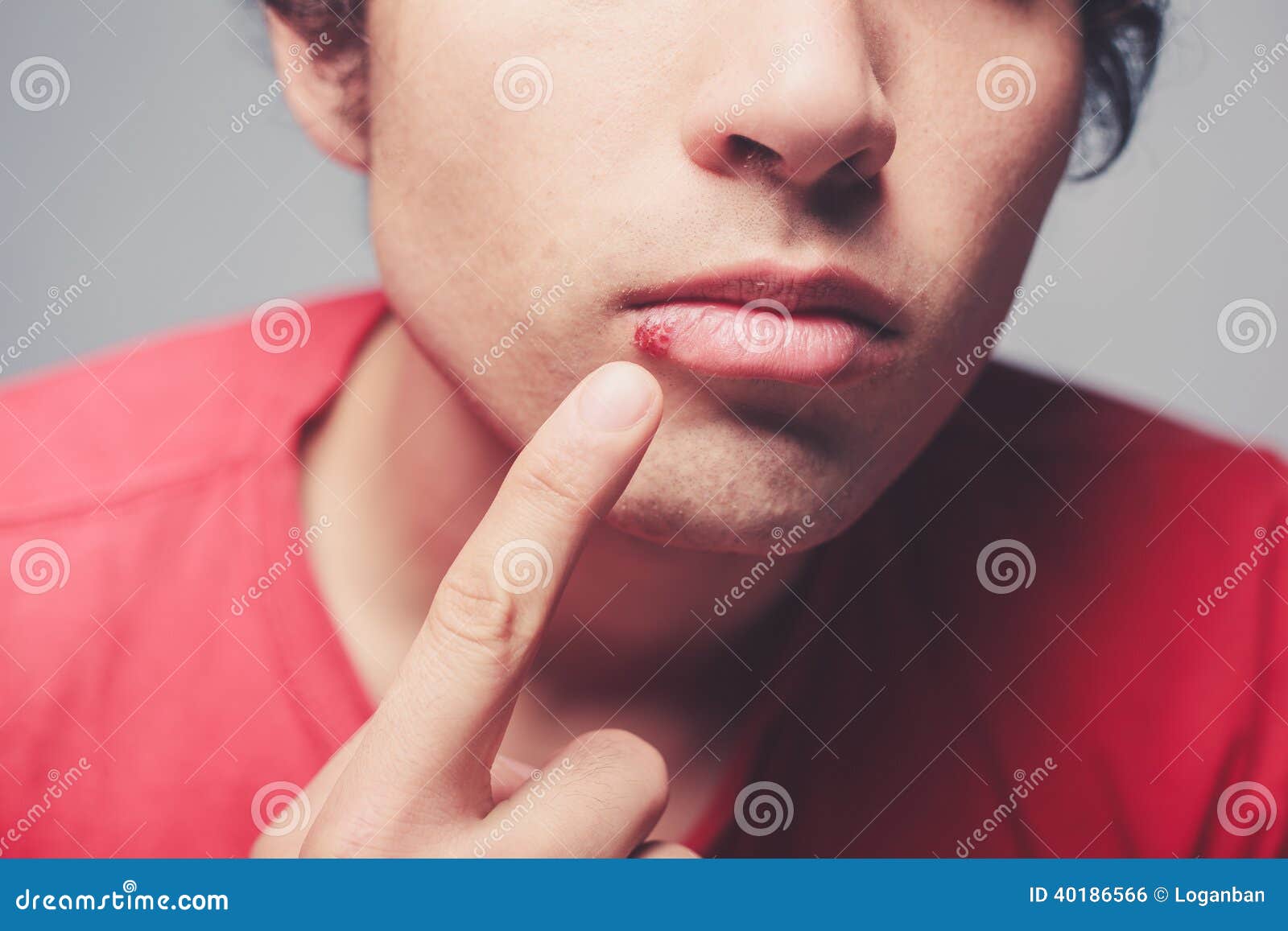 Young man with cold sore stock photo. Image of swollen - 40186566