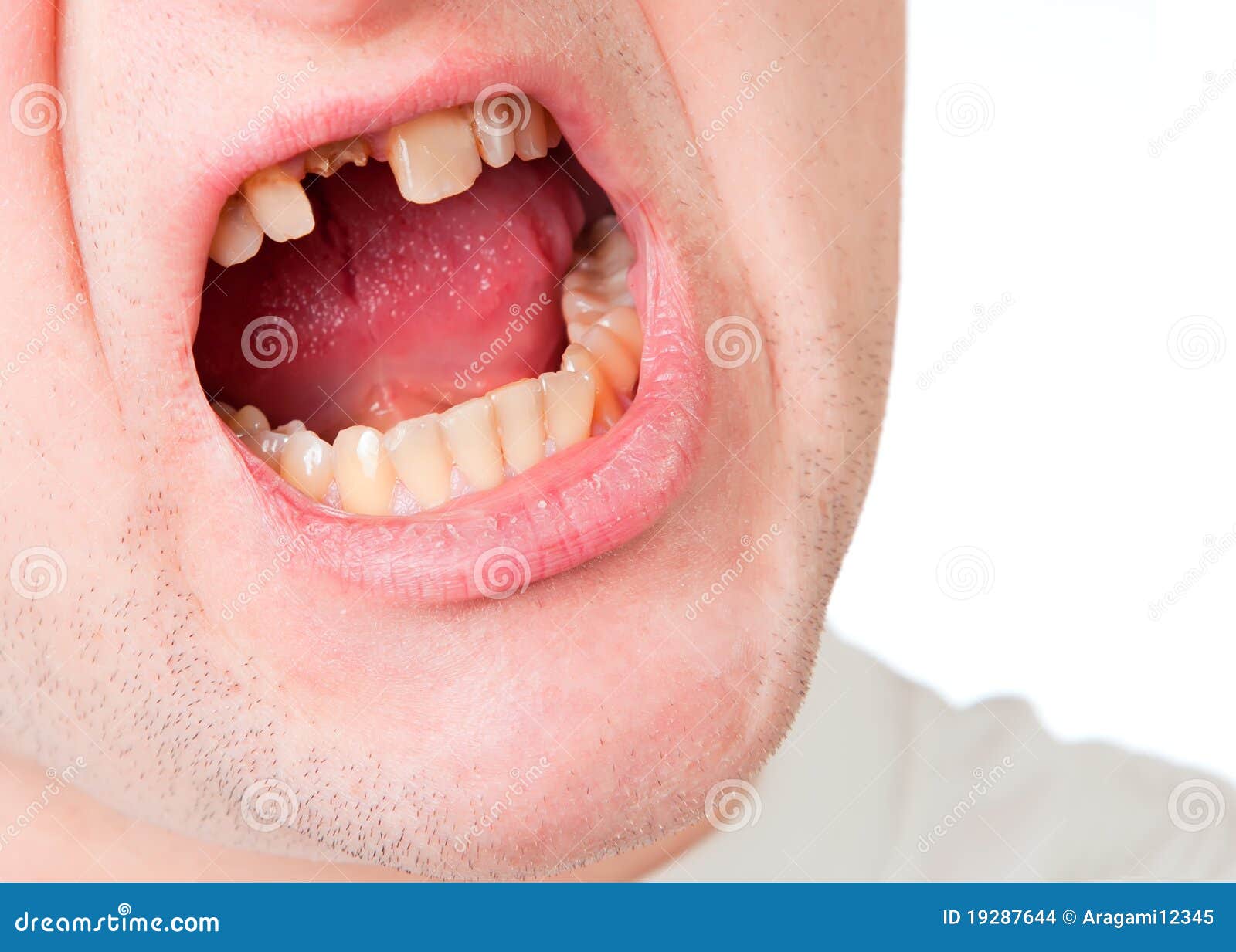 Young Man Face with Broken Tooth Stock Photo - Image of background ...