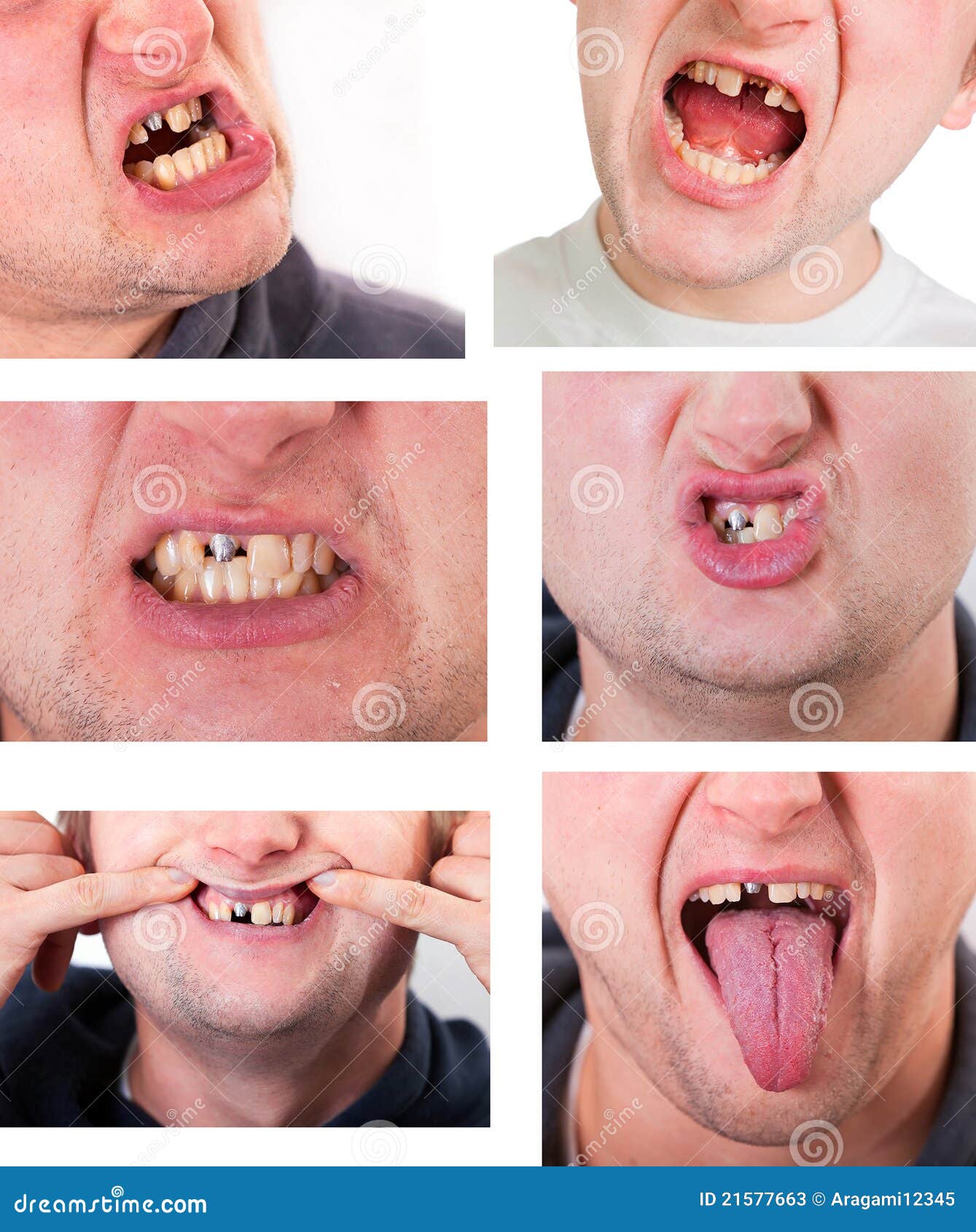 Young Man Face with Broken Tooth Stock Image - Image of patient, health ...