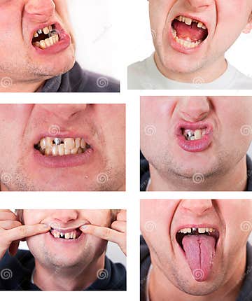 Young Man Face with Broken Tooth Stock Image - Image of patient, health ...