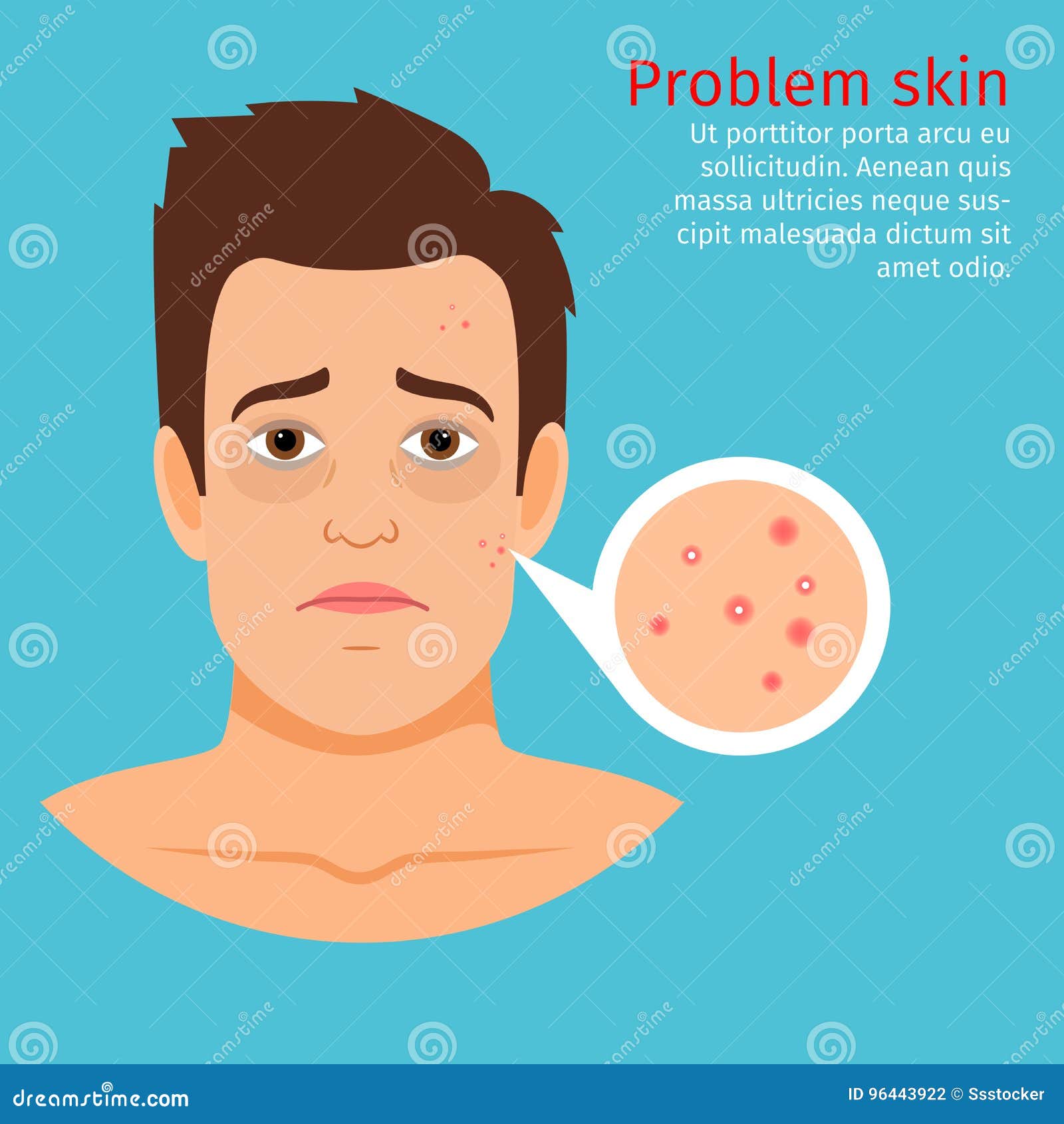 Young Man Face Problem Skin Acne Stock Vector - Illustration of ...