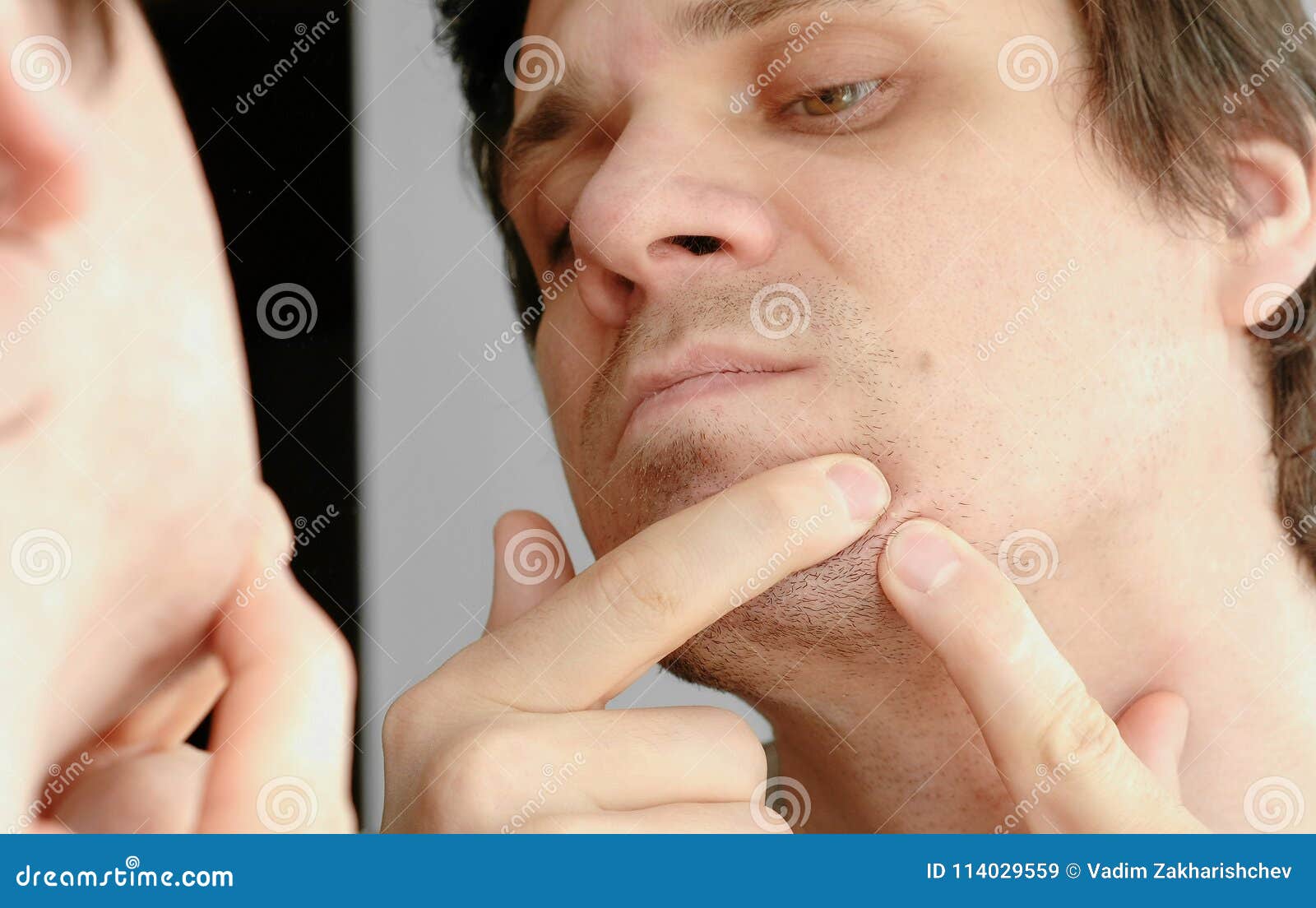 Pimple Extreme On Human Skin. Royalty-Free Stock Photography ...