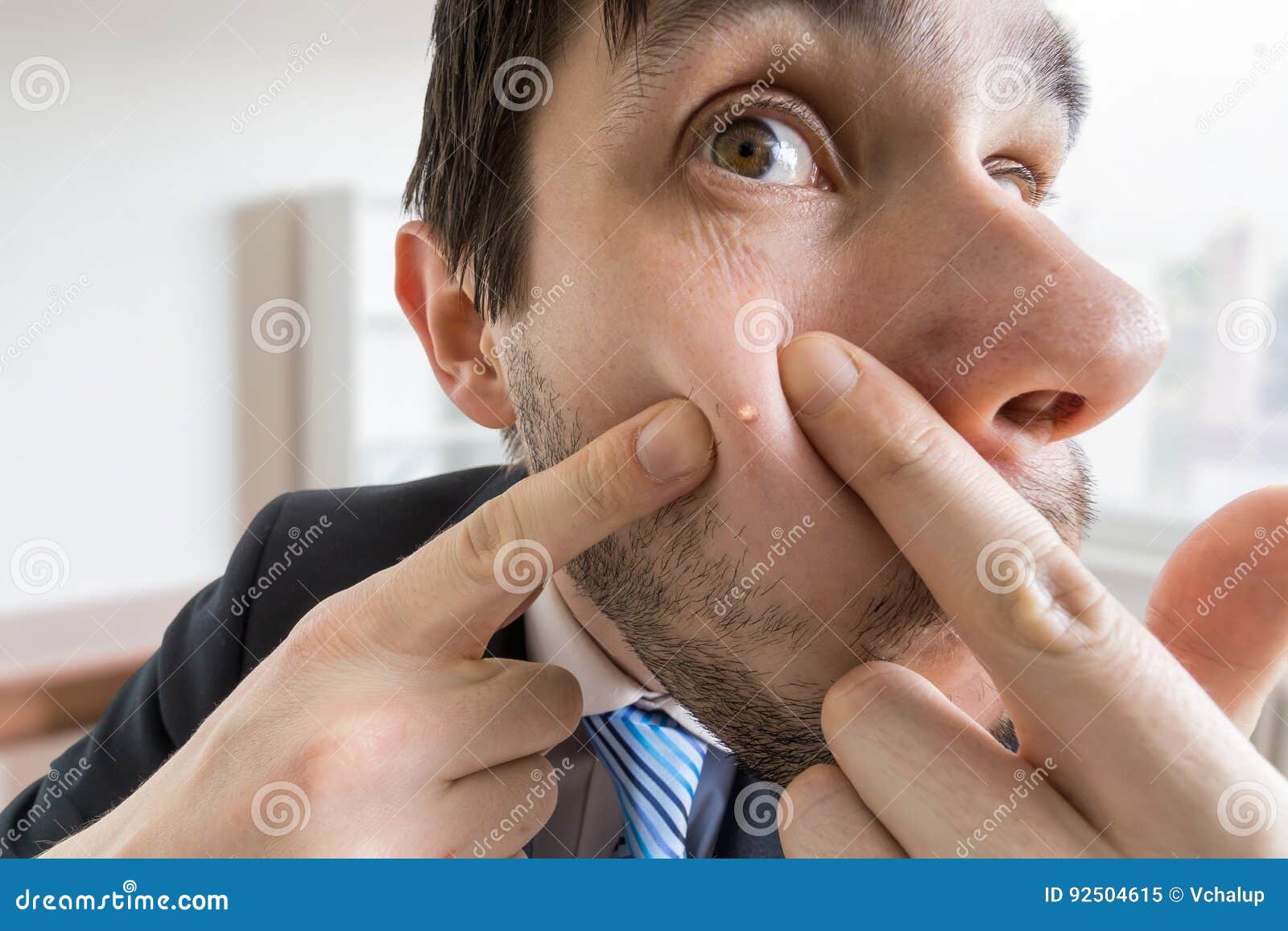 Young Man is Squeezing Pimple or Acne on His Skin Stock Image - Image ...